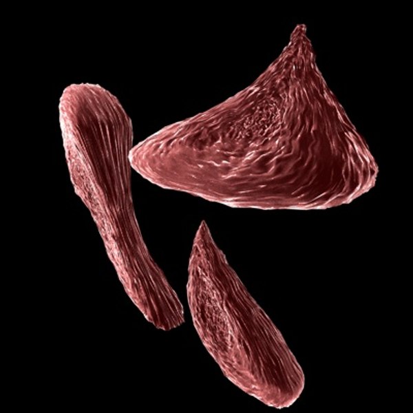 modelo 3d Anemia falciforme - TurboSquid 493471