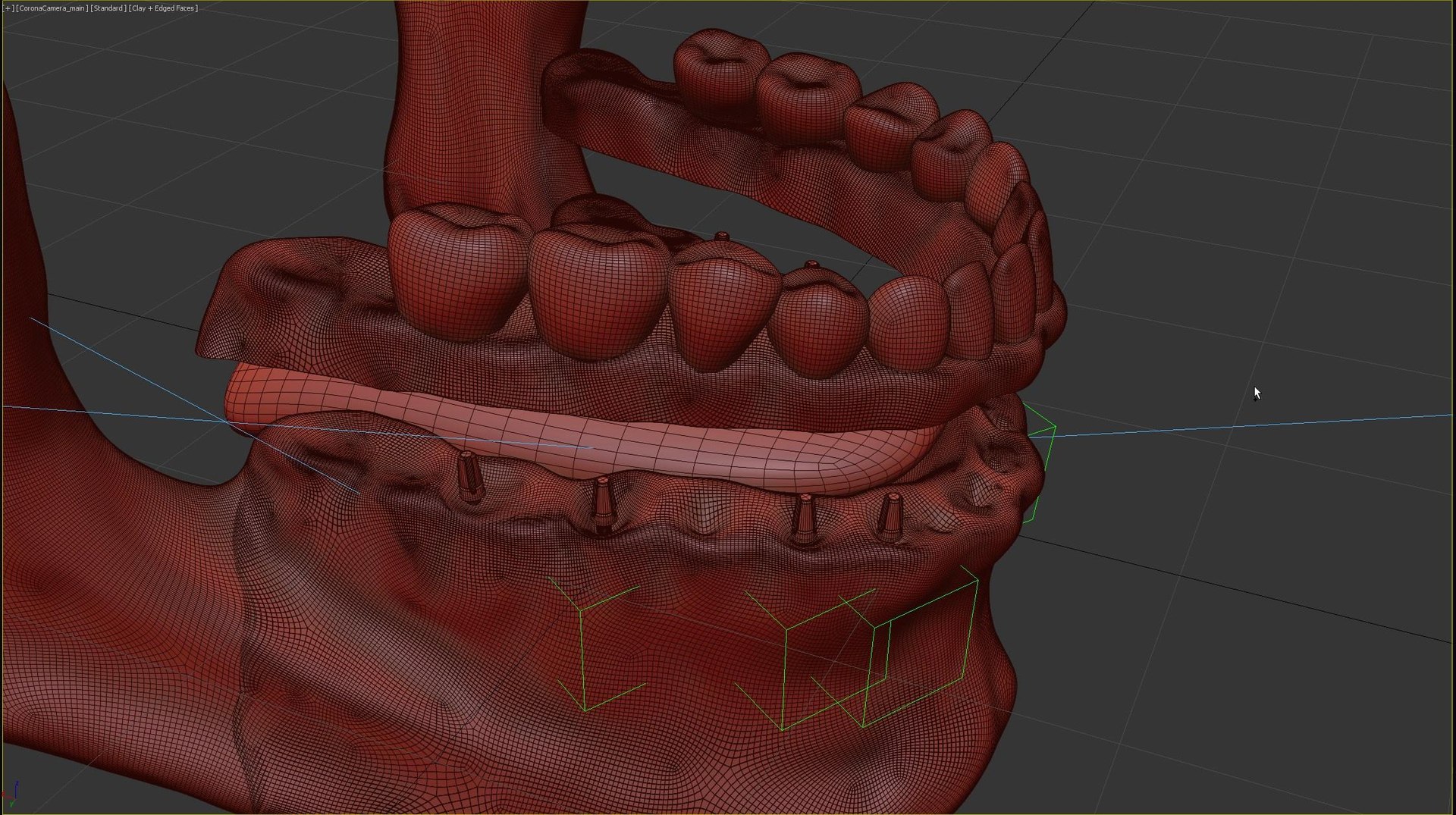 Jaws With Dental Implants Animation Model - TurboSquid 1798860
