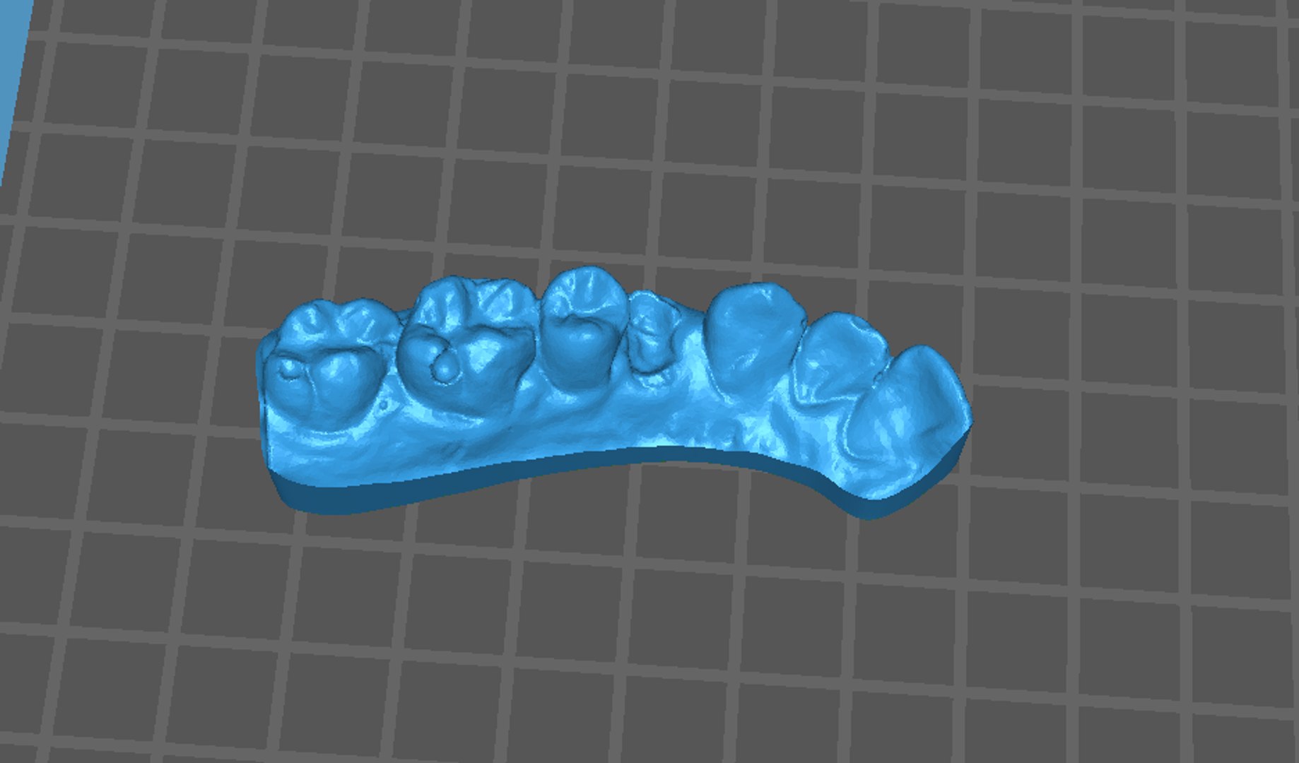 3D 2-Unit Dental Bridge Design Model - TurboSquid 2337409