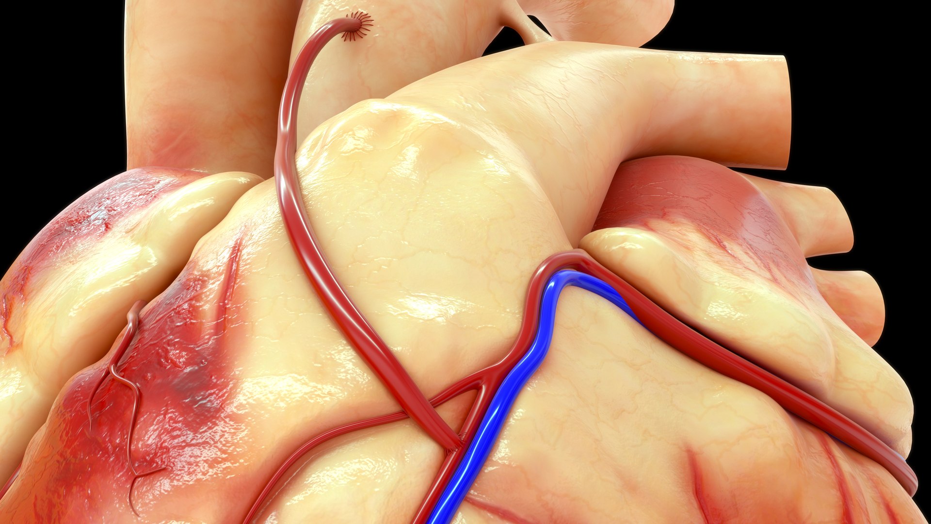 3D Coronary Artery Bypass Grafting - TurboSquid 2308657