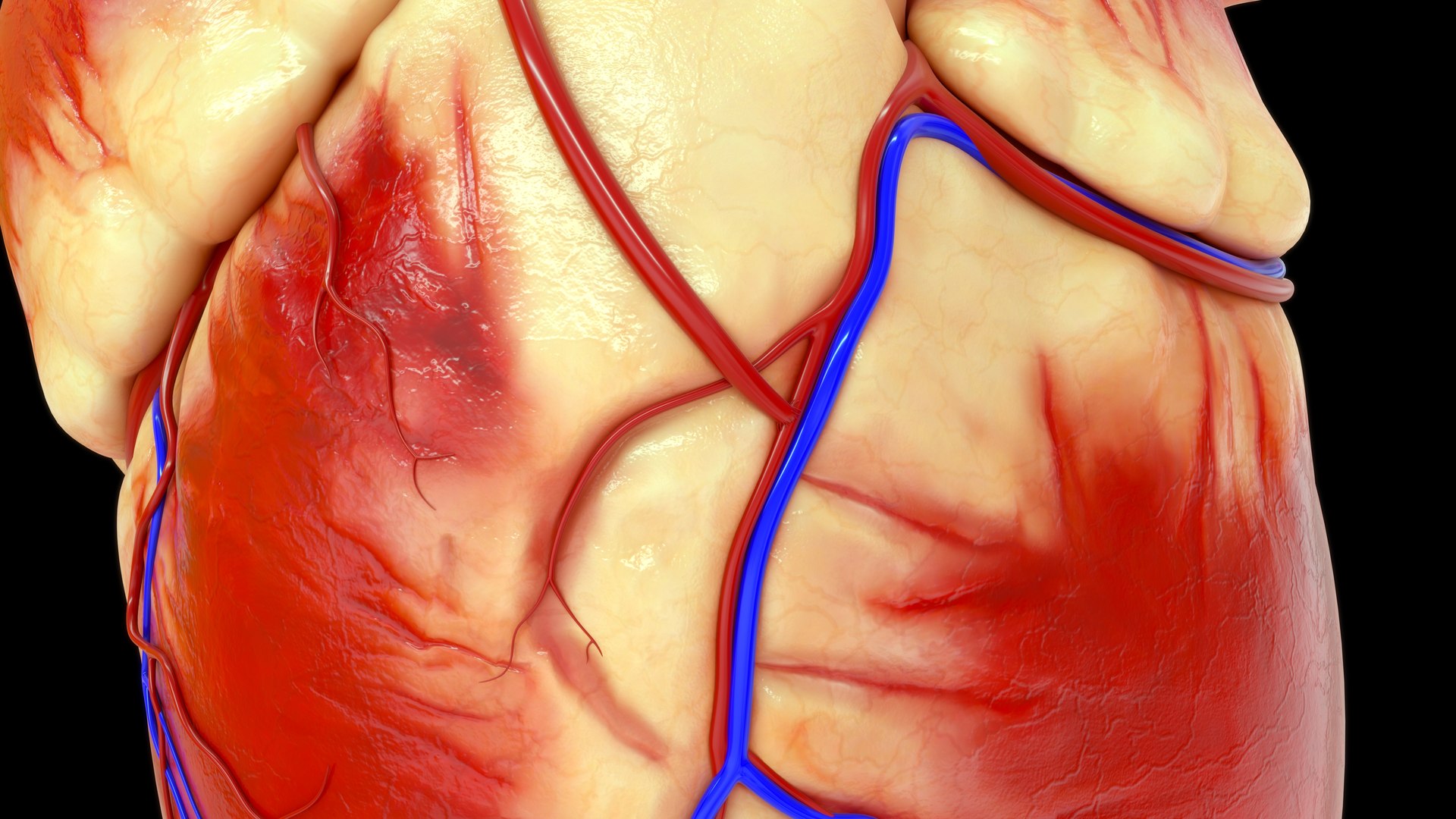3D Coronary Artery Bypass Grafting - TurboSquid 2308657