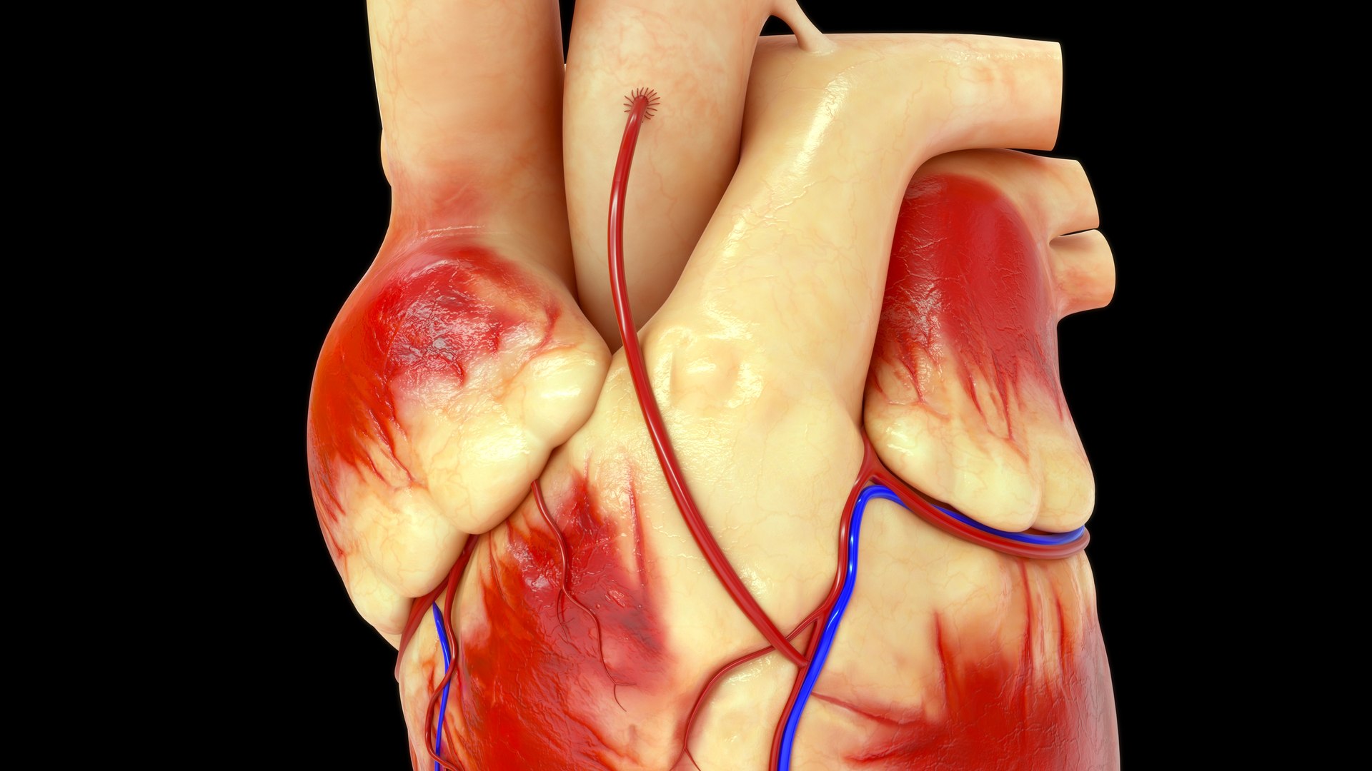 3D Coronary Artery Bypass Grafting - TurboSquid 2308657