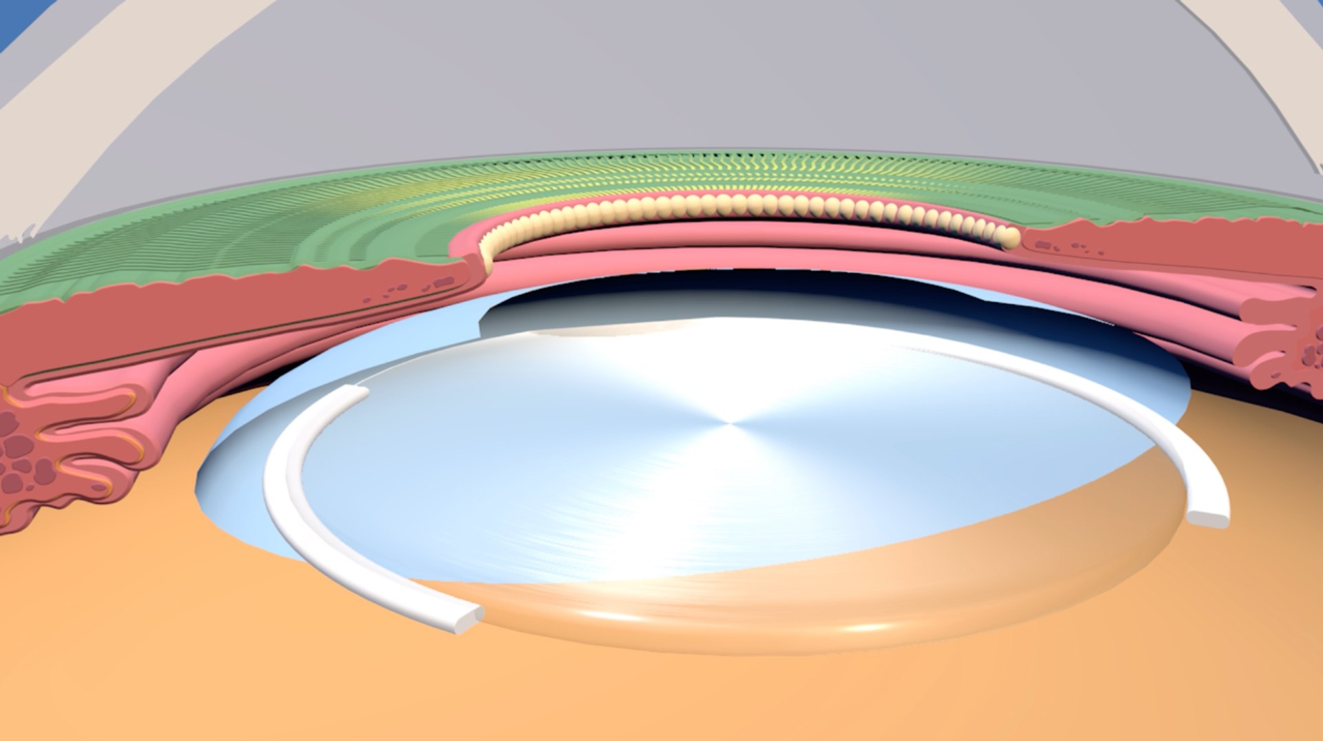 3D Eye Cataract Surgery Clamp Model - TurboSquid 1196471