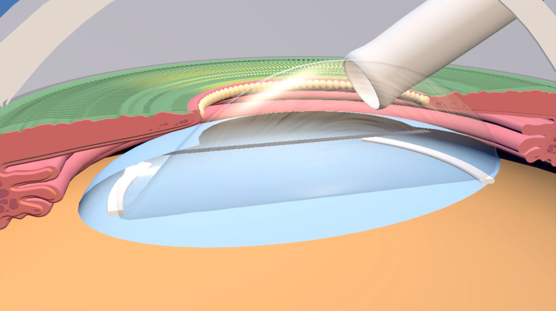 3D Eye Cataract Surgery Clamp Model - TurboSquid 1196471