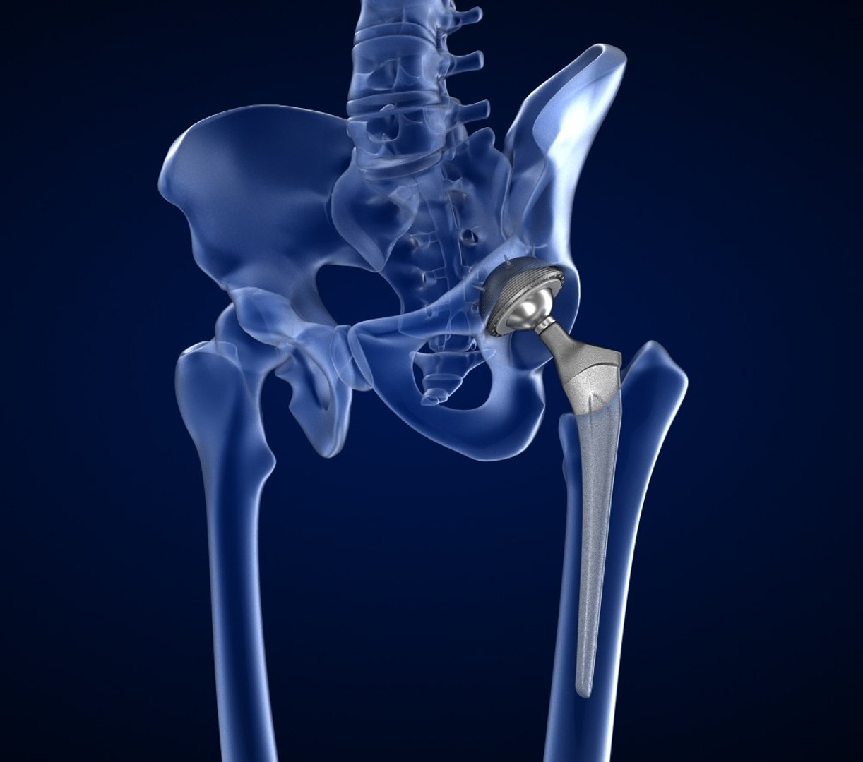 3D Hip Replacement Implant Installed Model - TurboSquid 1220758