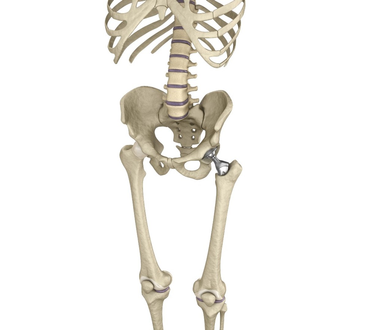 3D Hip Replacement Implant Installed Model - TurboSquid 1220758