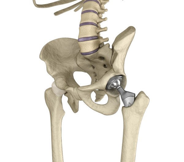 3D hip replacement implant installed model - TurboSquid 1220758