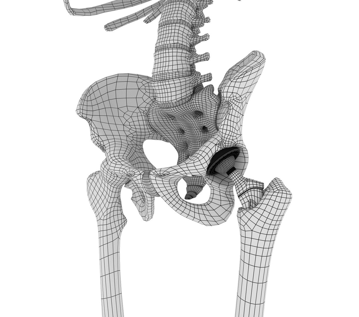 3D Hip Replacement Implant Installed Model - TurboSquid 1220758