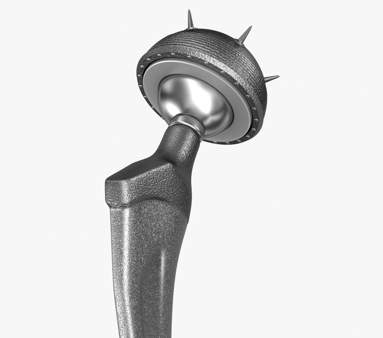 3D Hip Replacement Implant Installed Model - TurboSquid 1220758