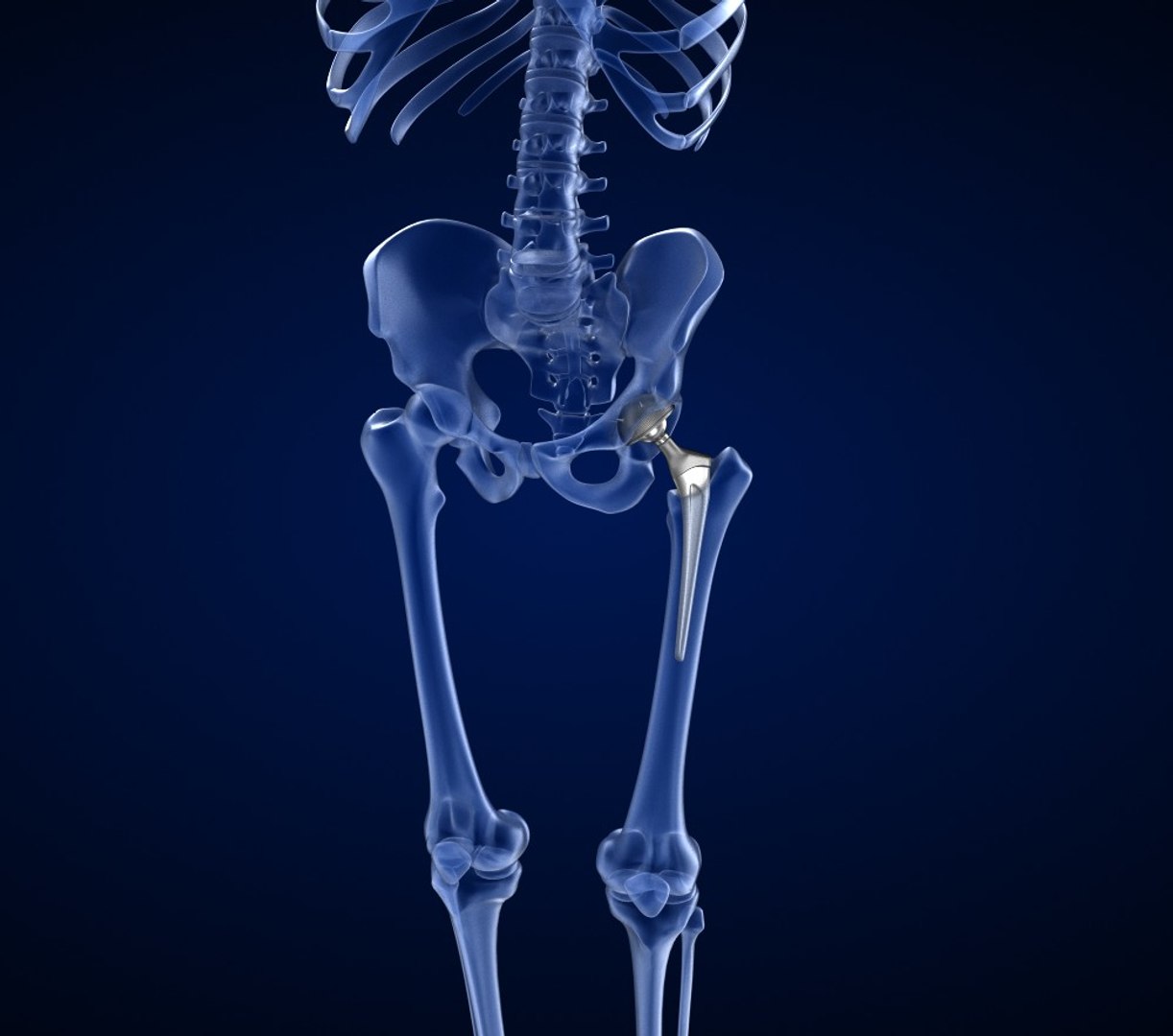 3D Hip Replacement Implant Installed Model - TurboSquid 1220758