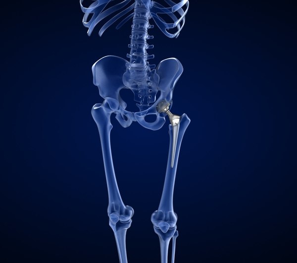3D hip replacement implant installed model - TurboSquid 1220758
