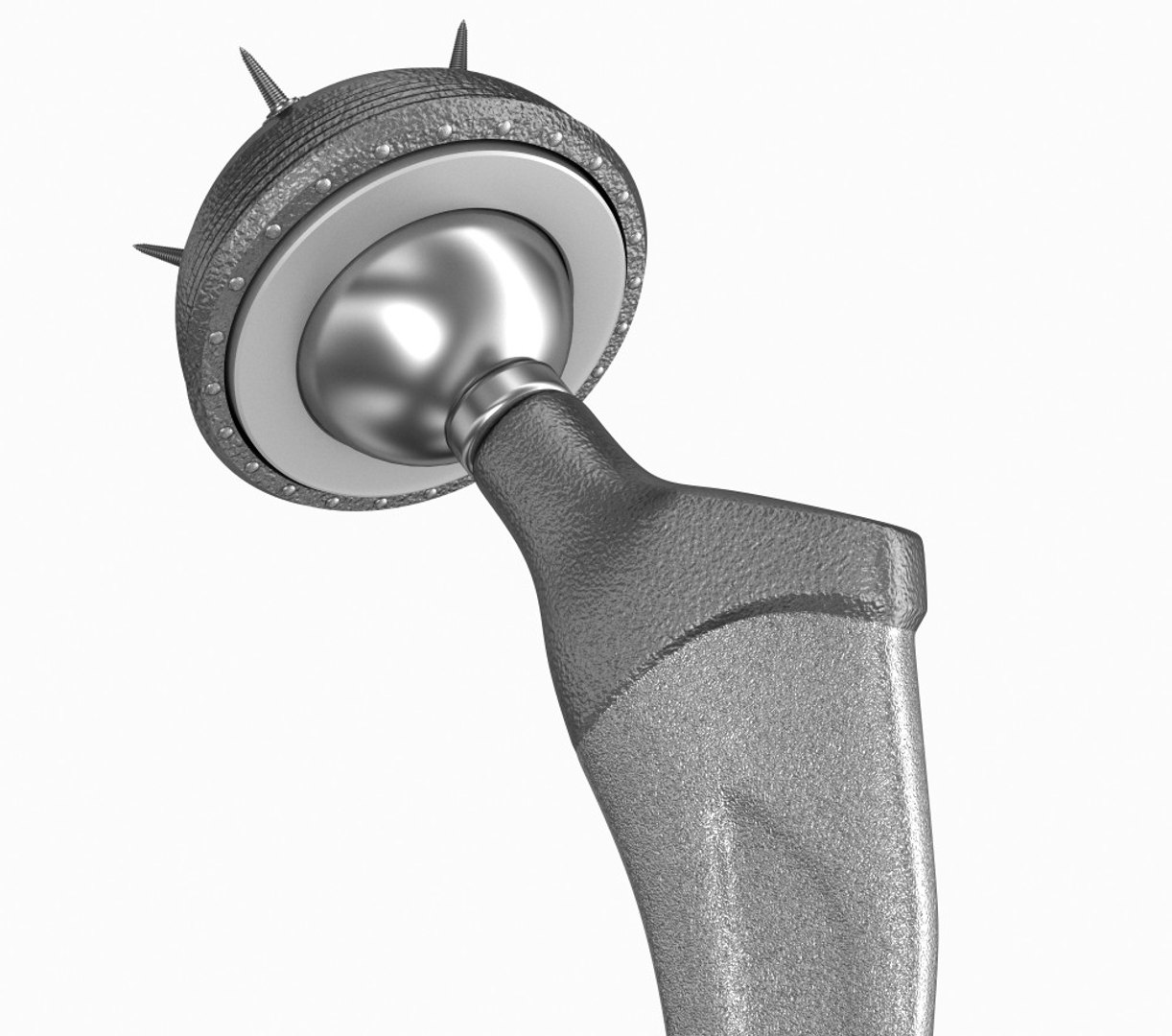 3D Hip Replacement Implant Installed Model - TurboSquid 1220758