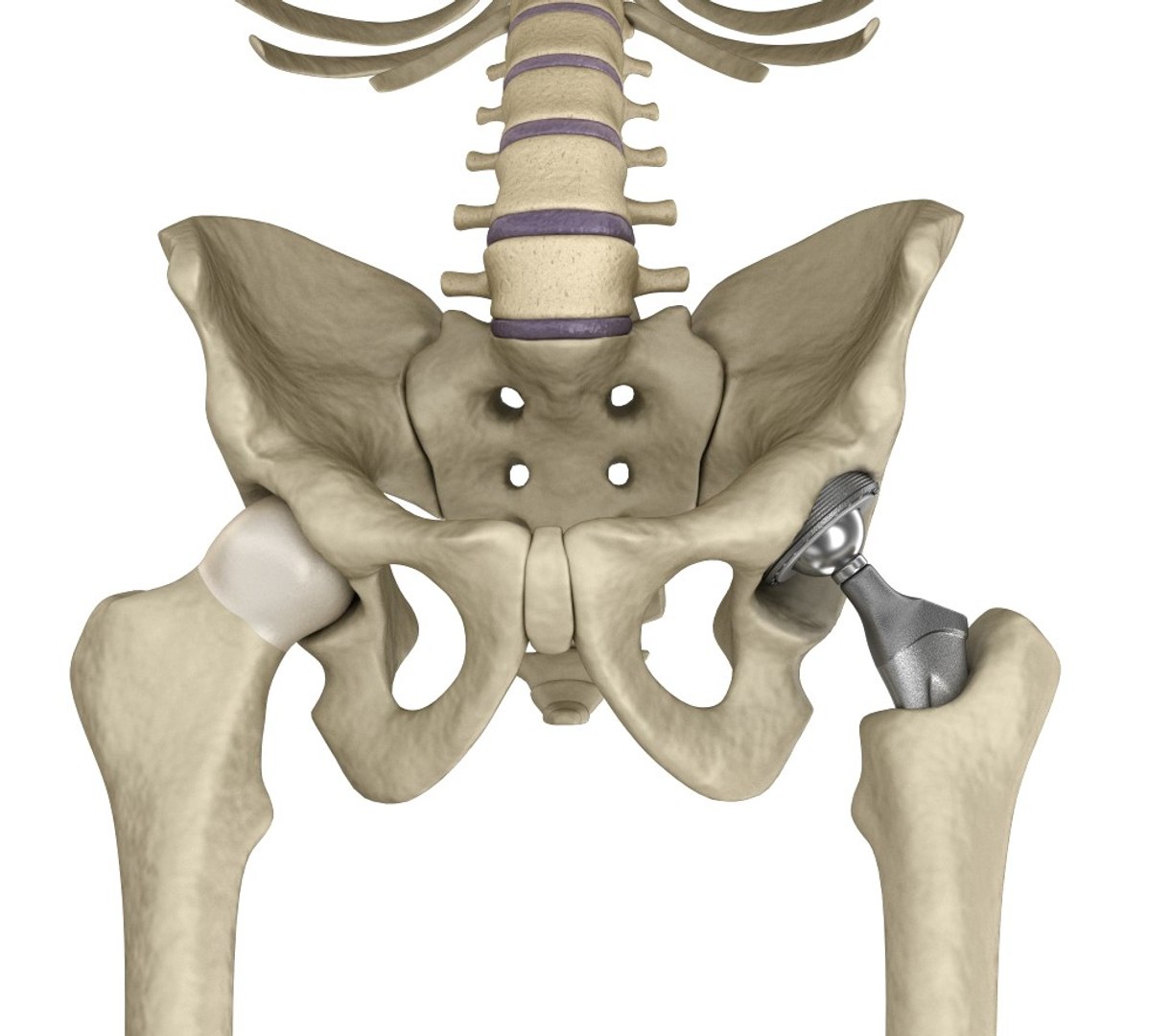 3D Hip Replacement Implant Installed Model - TurboSquid 1220758