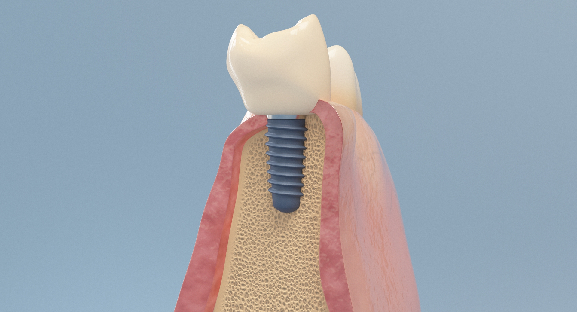 3D dental implant - TurboSquid 1405495