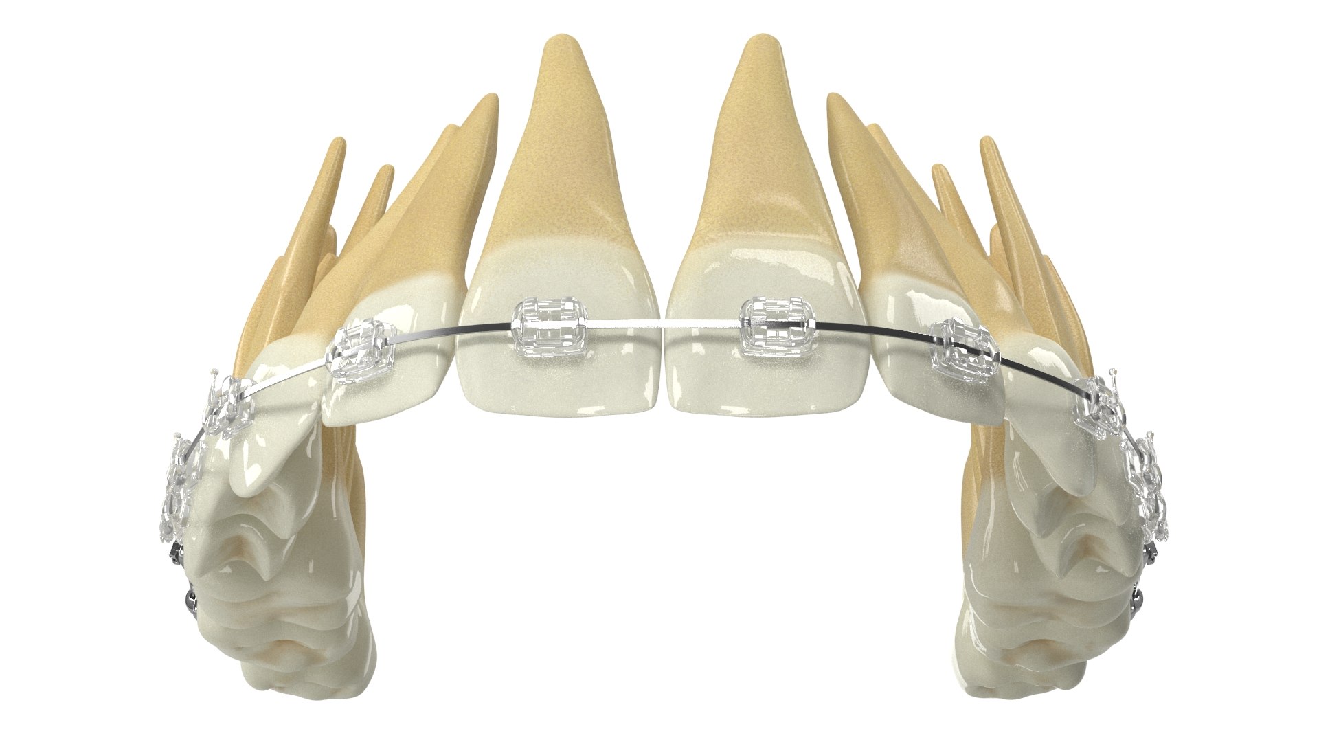 3D Human Teeth With Transparent Dental Braces V04 Model - TurboSquid ...