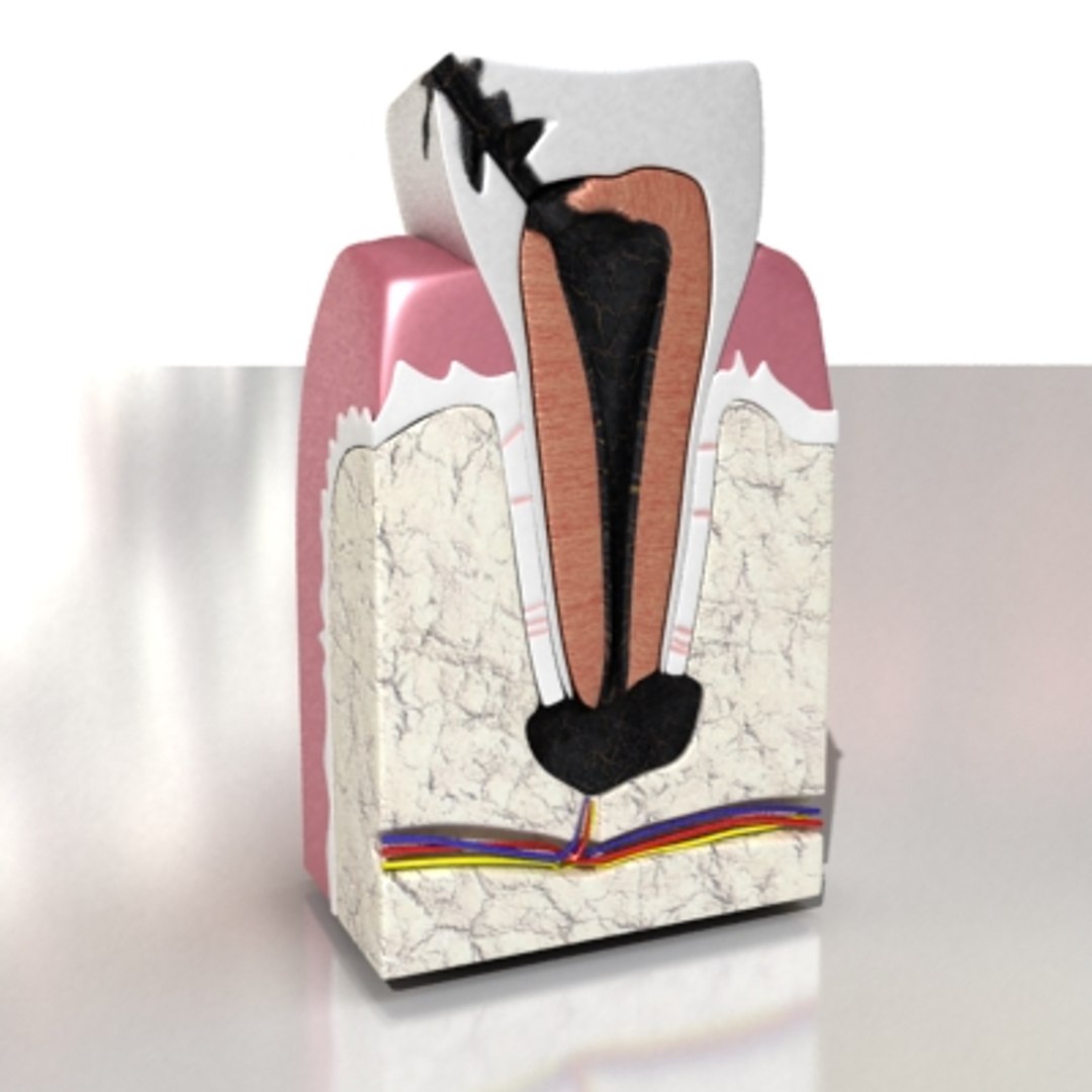 3d Tooth - Decay