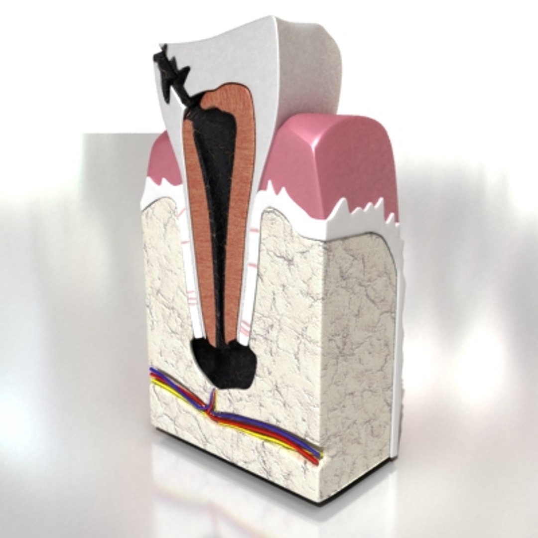 3d Tooth - Decay
