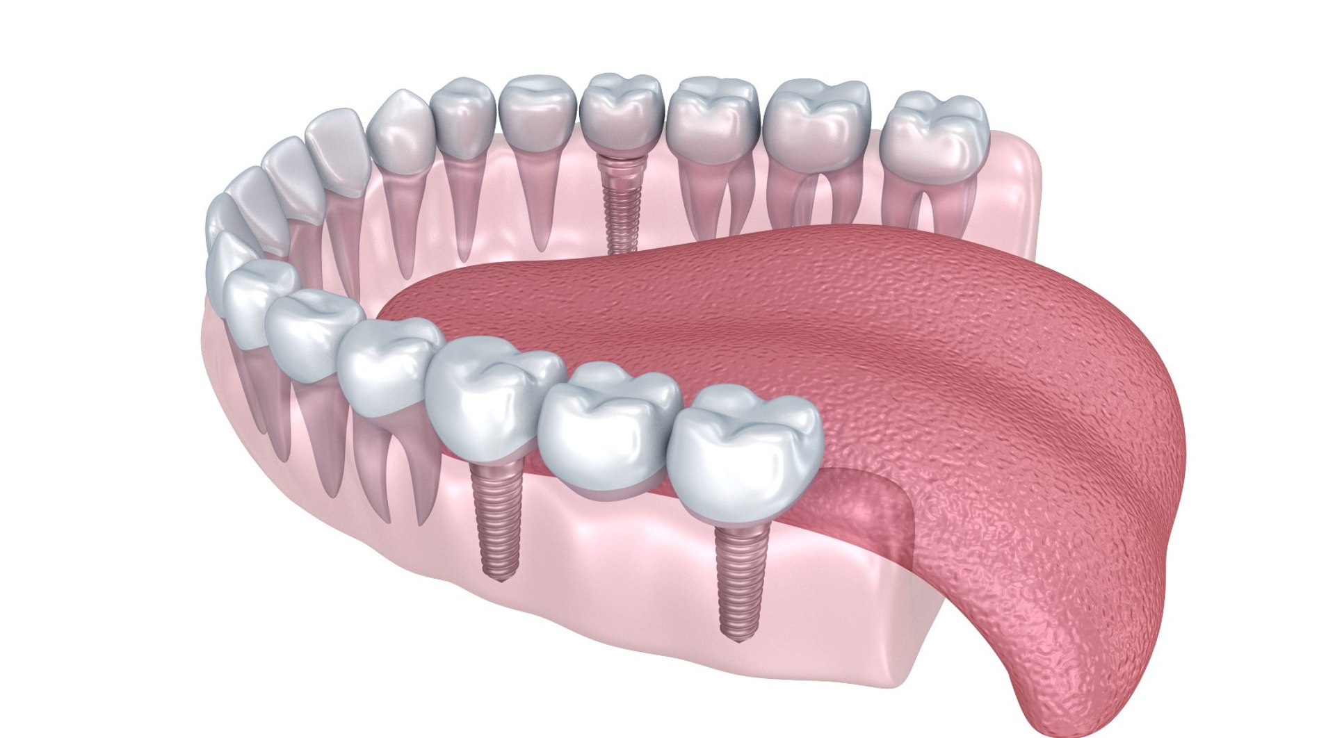 Lower Teeth Crown Dental 3d Max