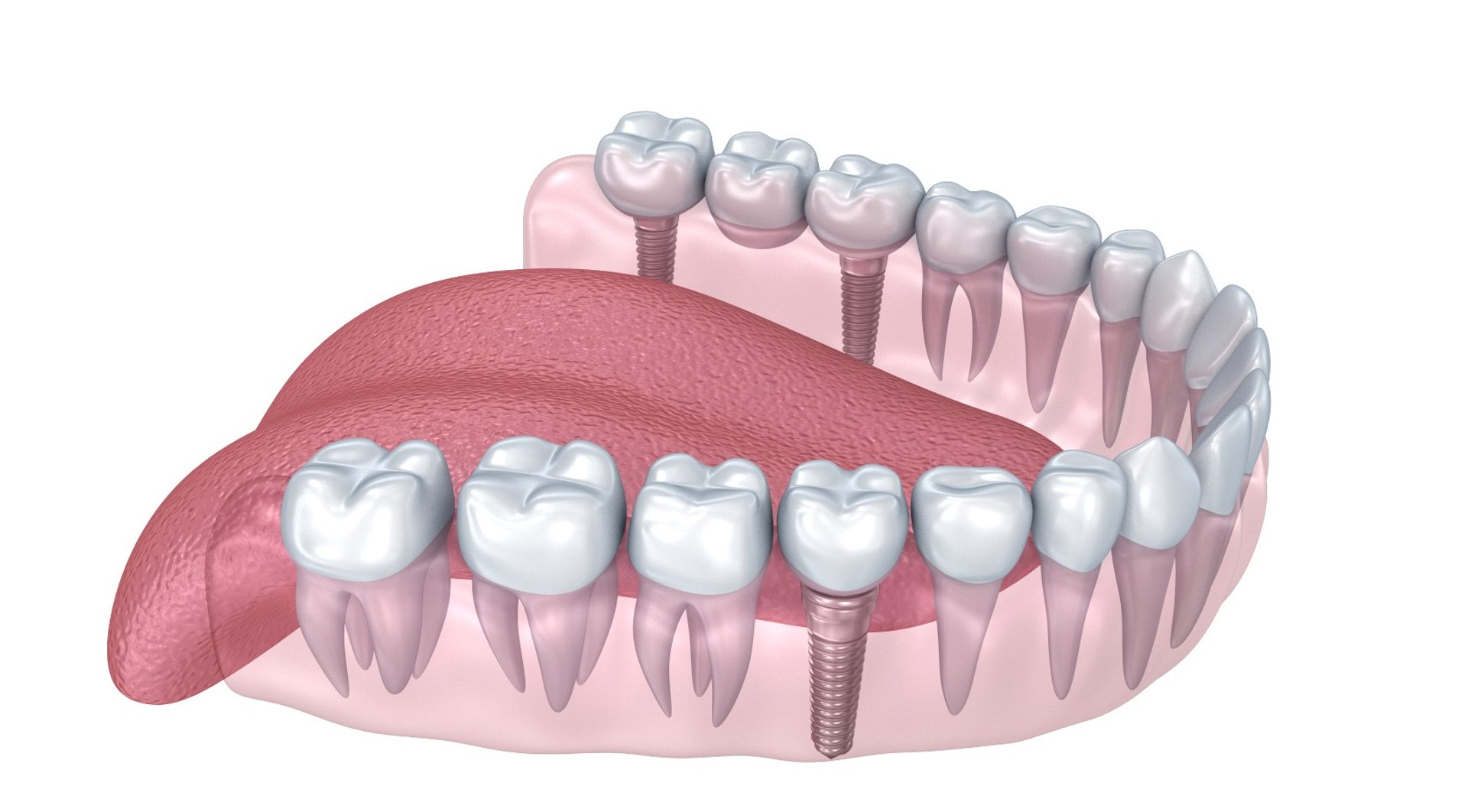 Lower Teeth Crown Dental 3d Max