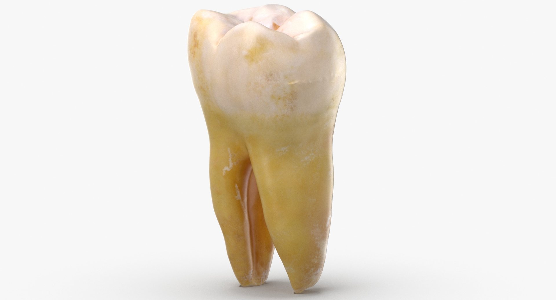 Human Lower Jaw Molars Teeth Clean and Damaged Collection - 7 models ...