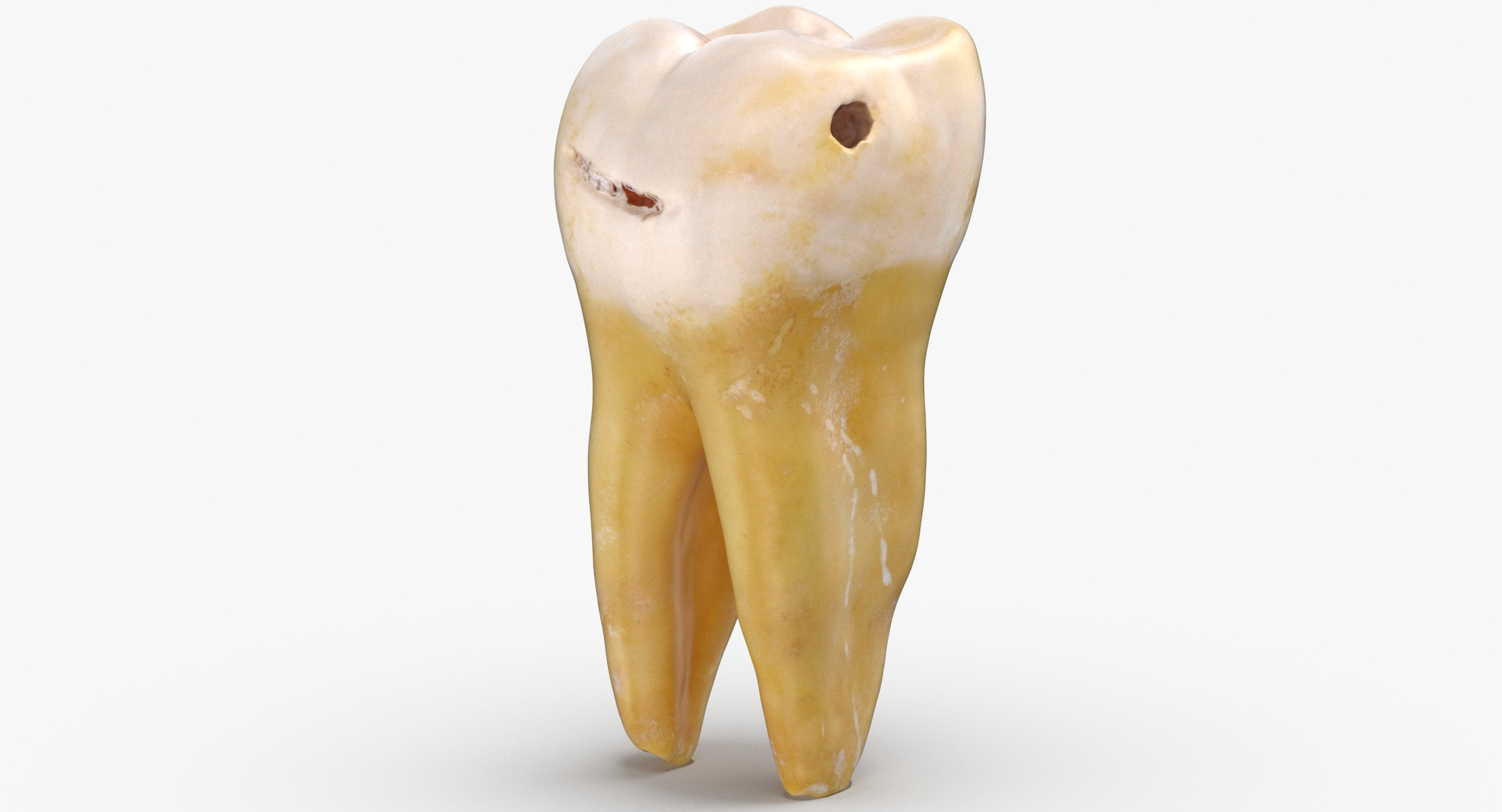 Human Lower Jaw Molars Teeth Clean and Damaged Collection - 7 models ...