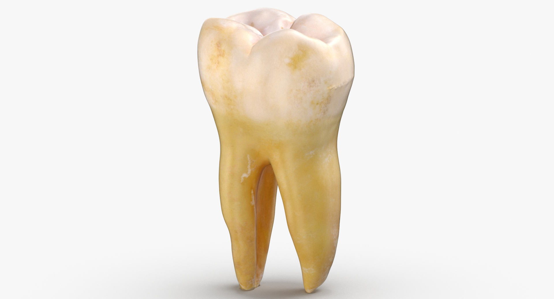 Human Lower Jaw Molars Teeth Clean and Damaged Collection - 7 models ...