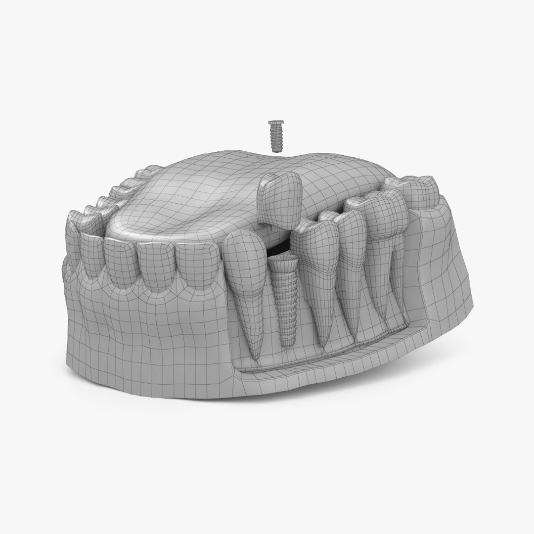 Dental Implant 3D model - TurboSquid 2181521
