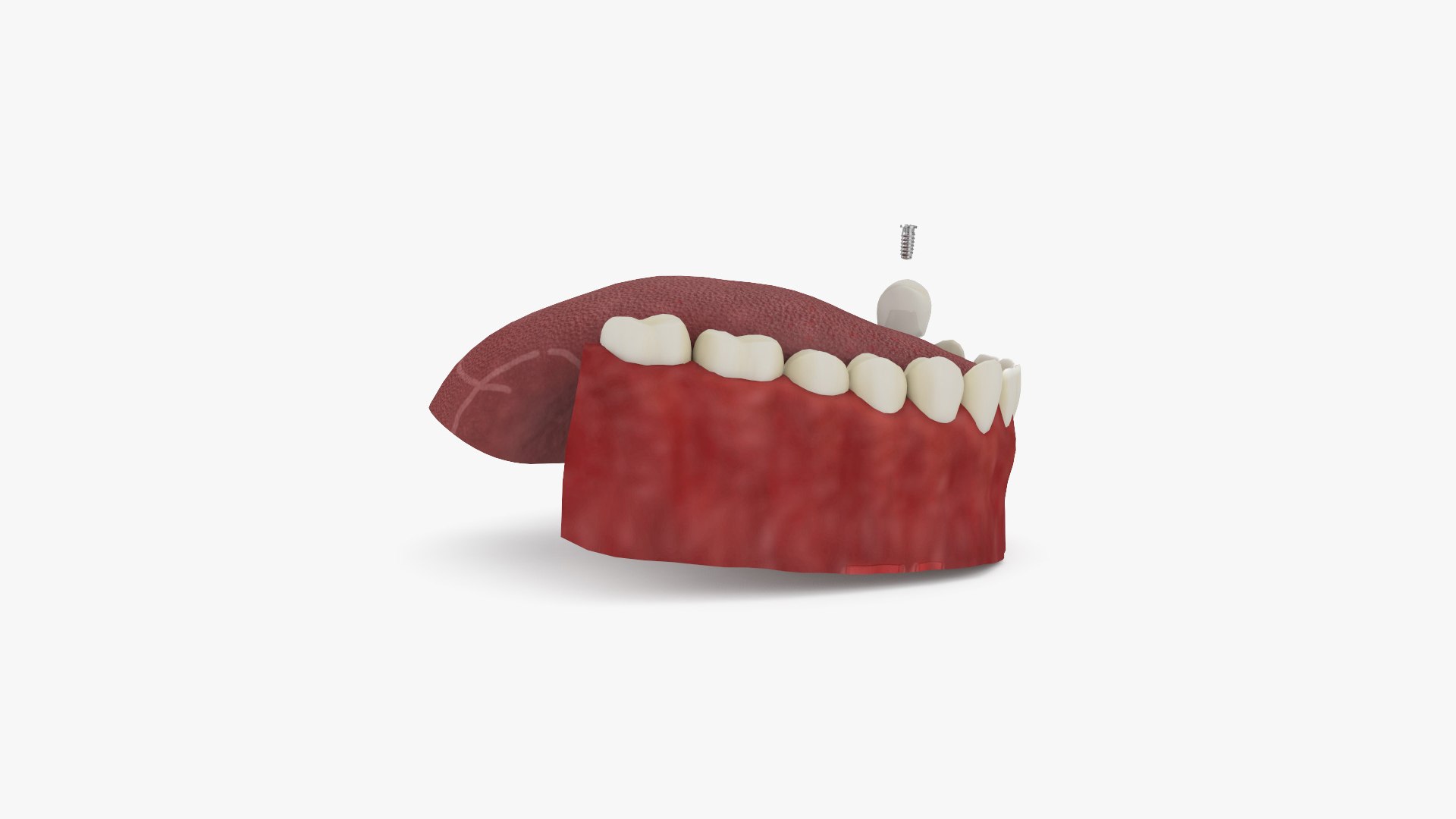 Dental Implant 3D model - TurboSquid 2181521