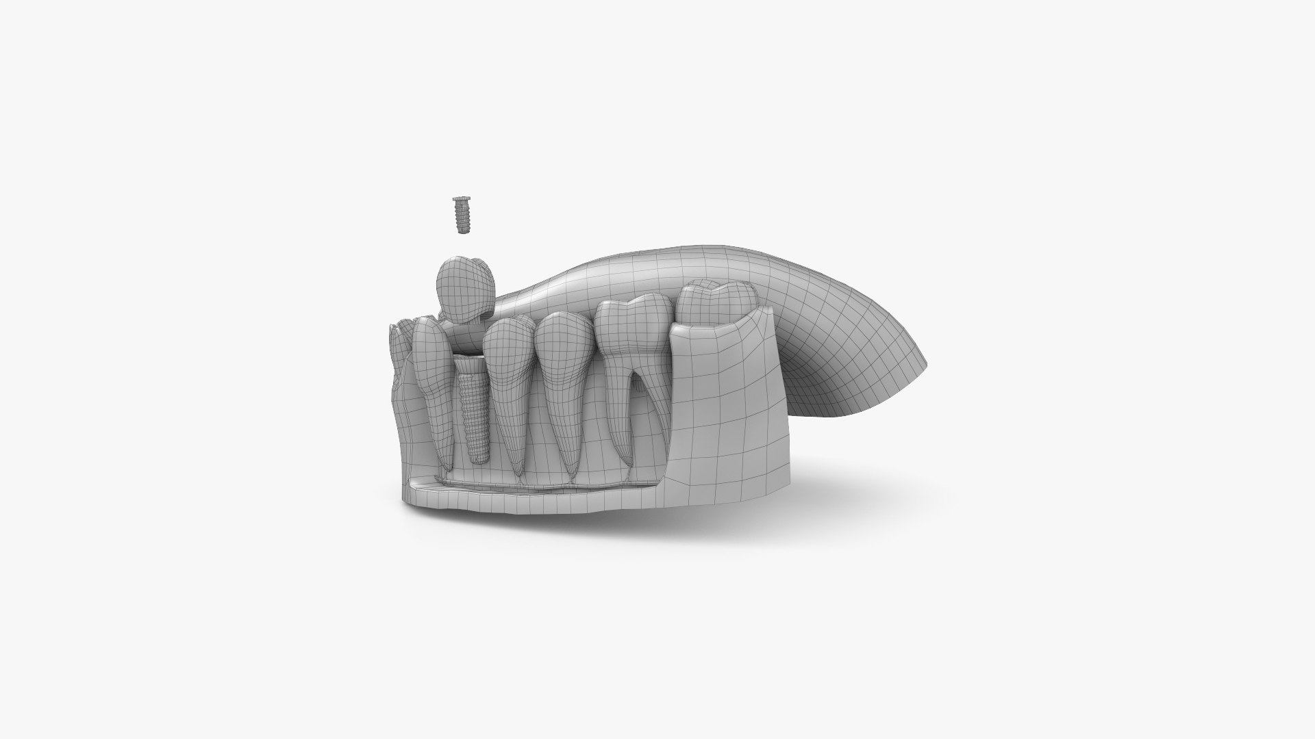 Dental Implant 3D model - TurboSquid 2181521