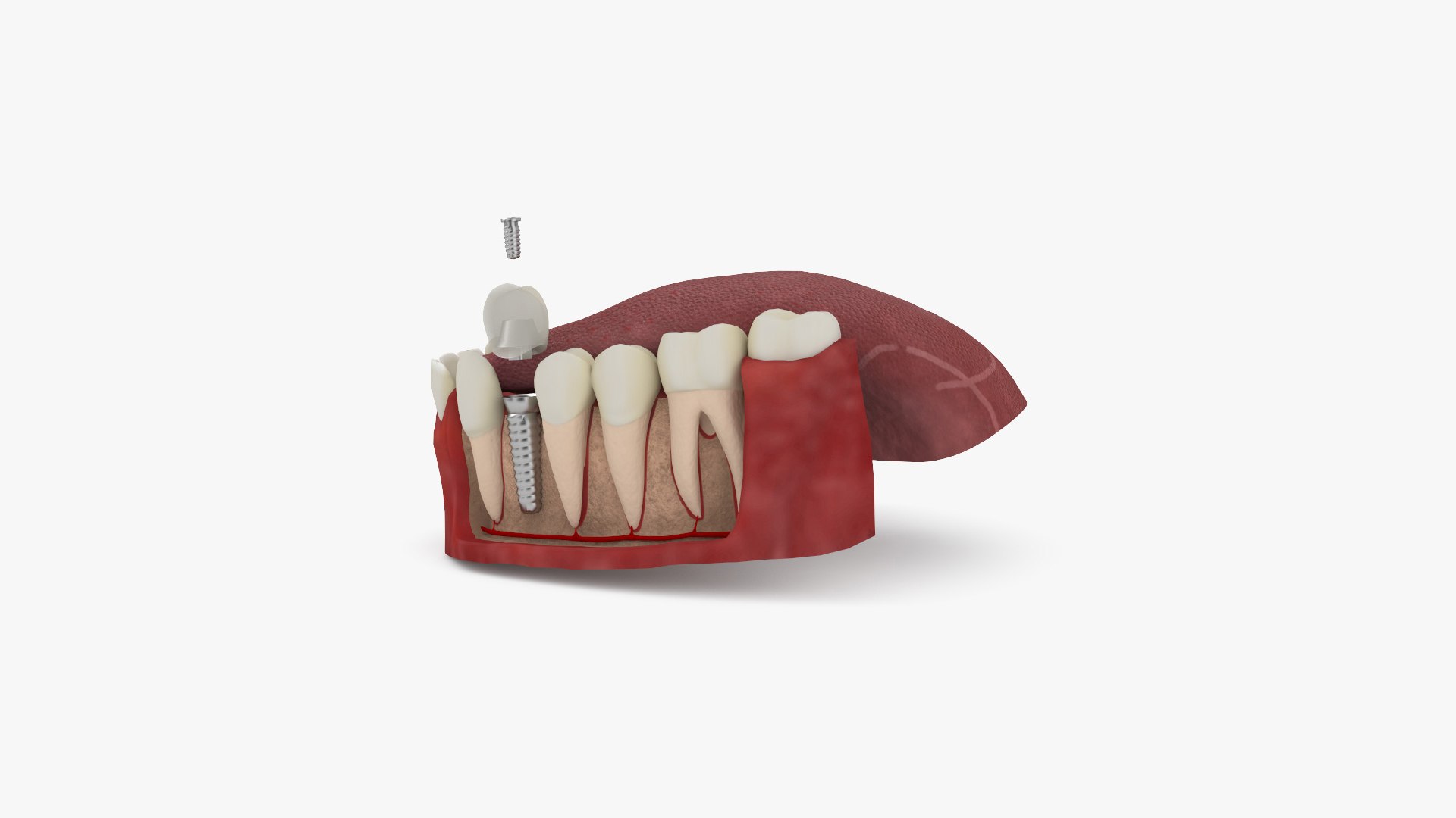 Dental Implant 3D model - TurboSquid 2181521
