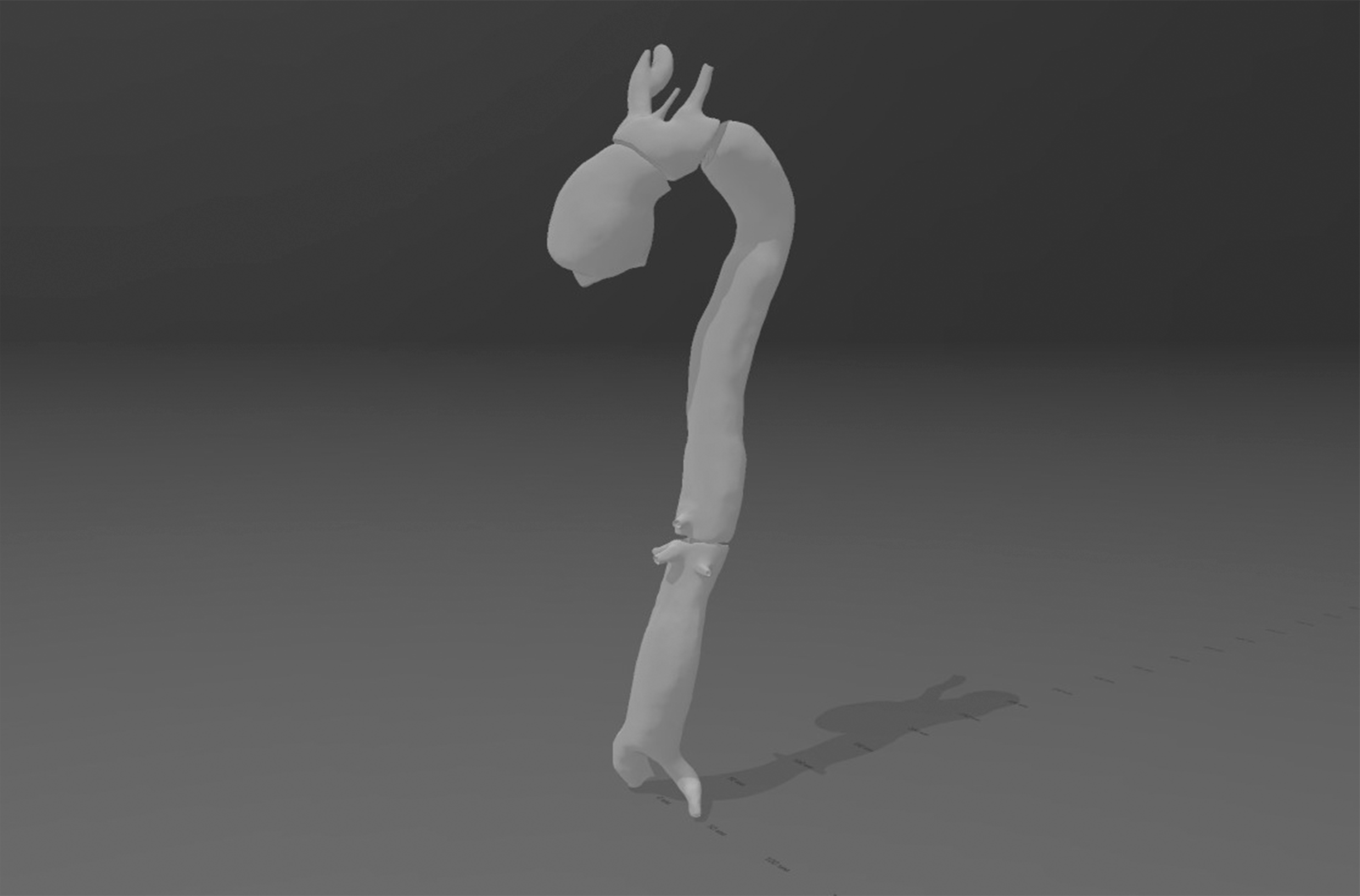 3d Aortic Dissection Model Turbosquid 2050738