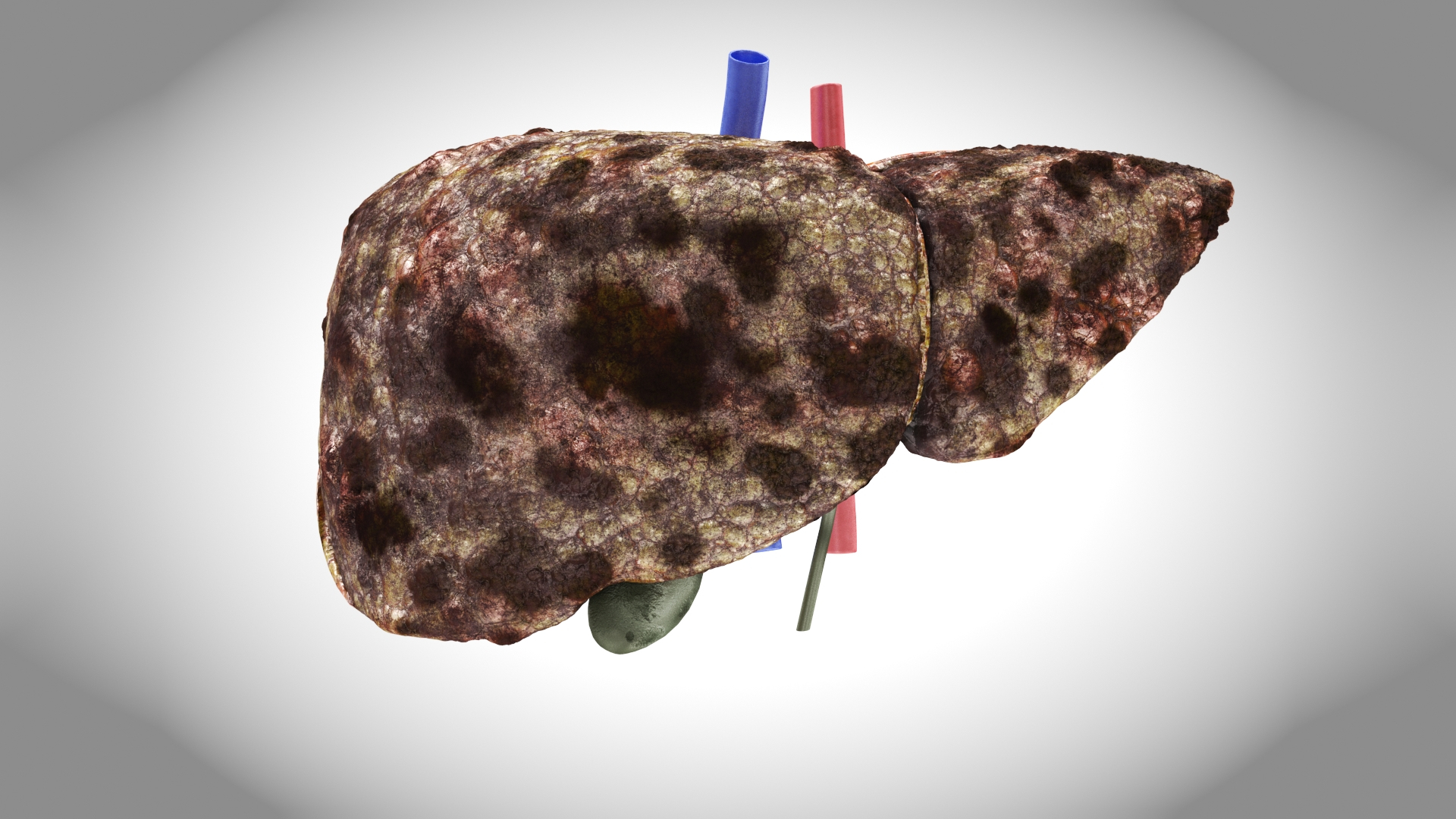 3D model Hepatocellular Carcinoma Liver - TurboSquid 2132826