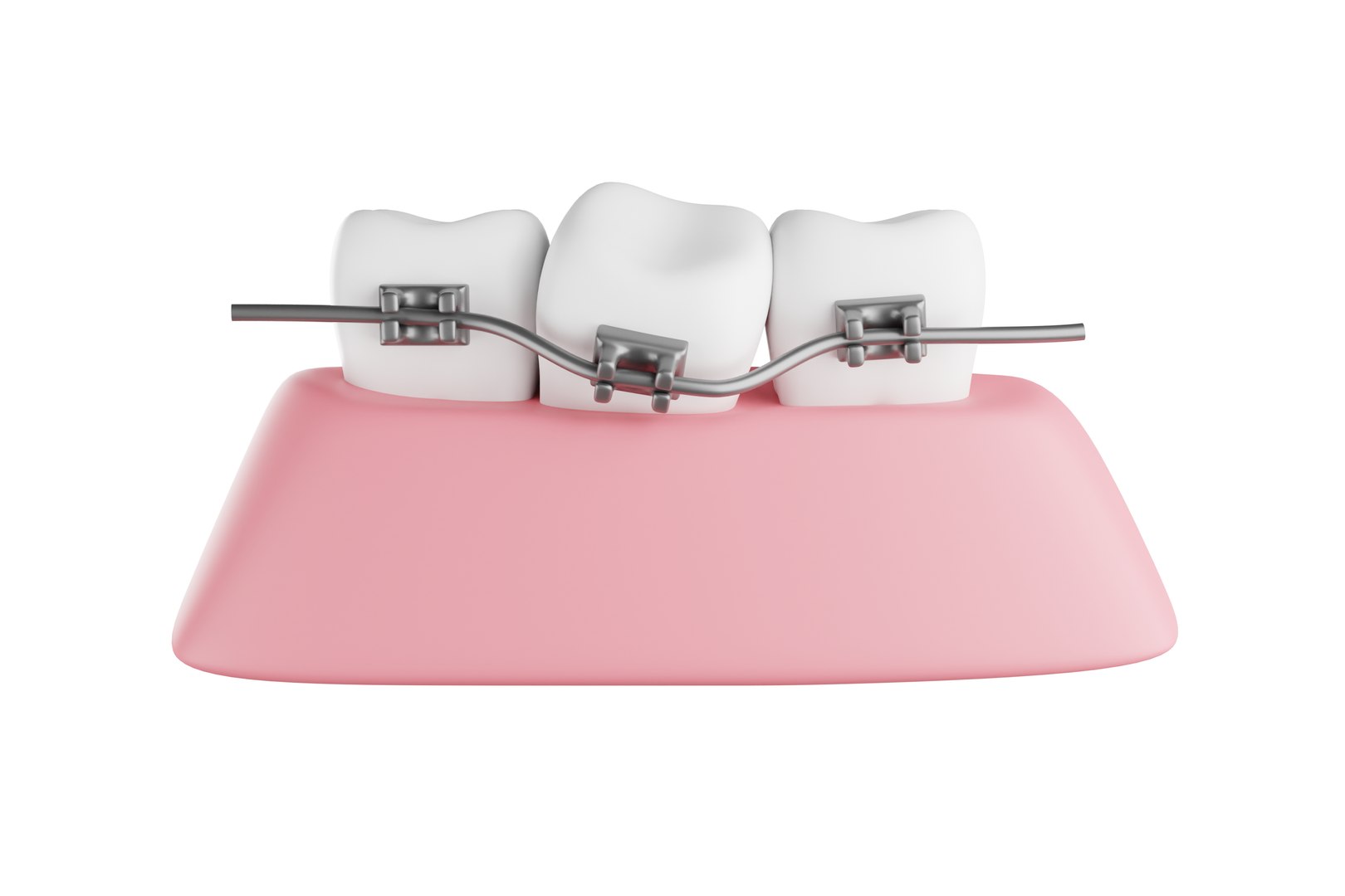 Dental braces system for bite correction 3D model - TurboSquid 2074481