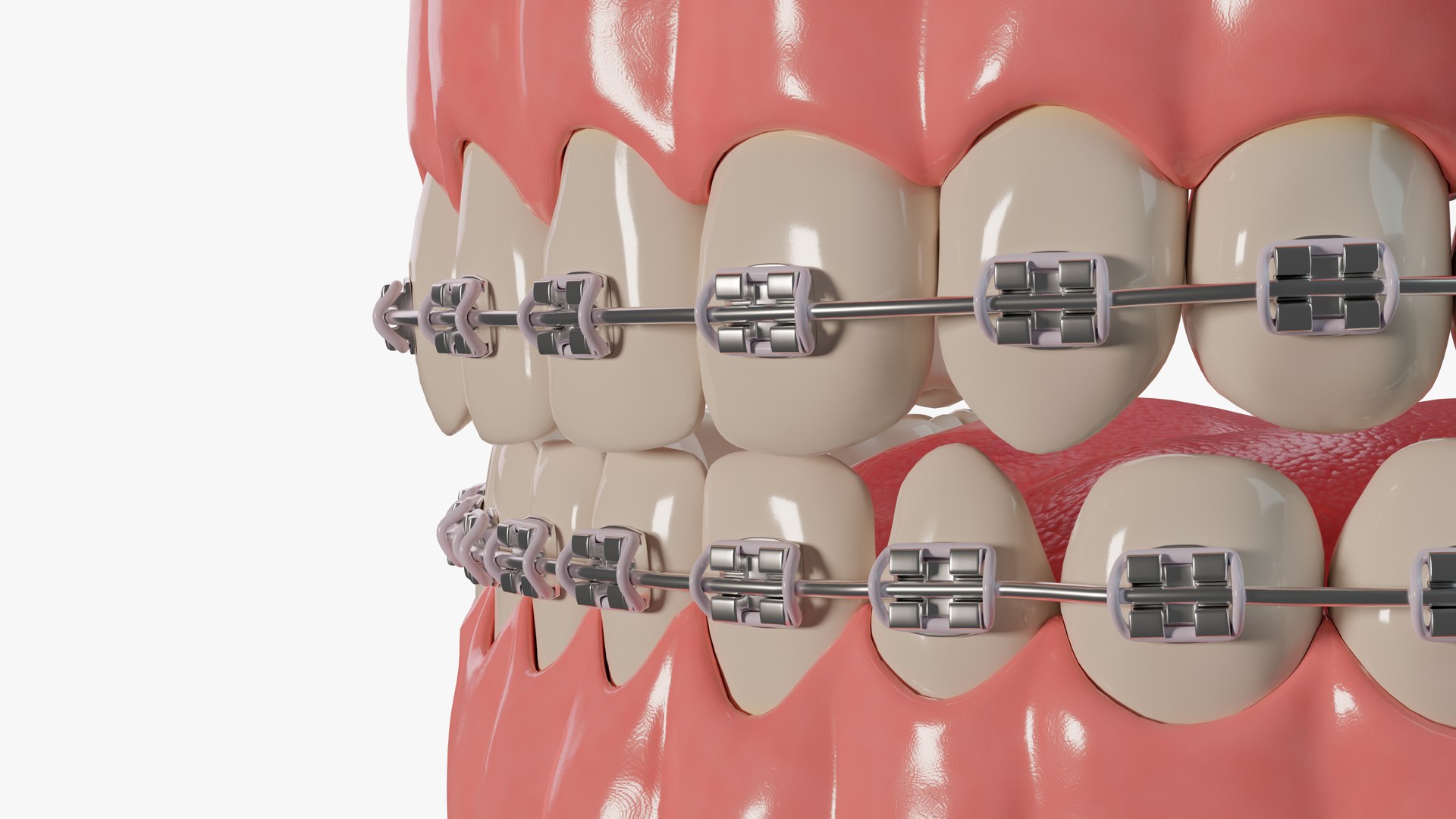3D Model Braces With Elastic Rubber Bands - TurboSquid 1869158