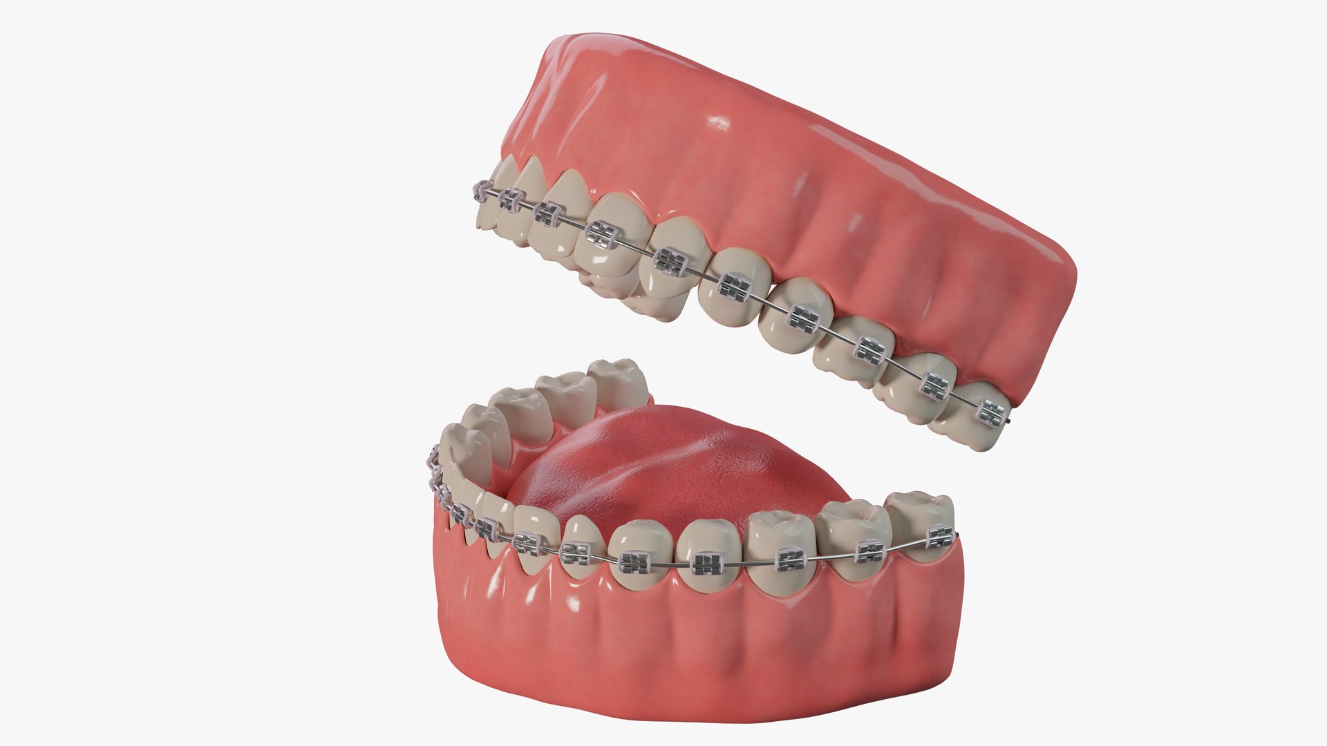 3D Model Braces With Elastic Rubber Bands - TurboSquid 1869158