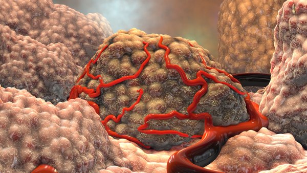 3D Tumor Models | TurboSquid