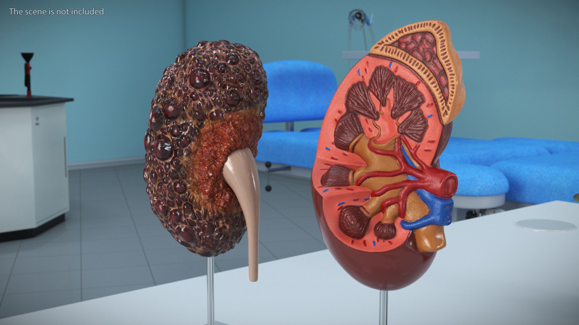 3D Kidney Comparison Model Healthy And Polycystic - TurboSquid 2411138