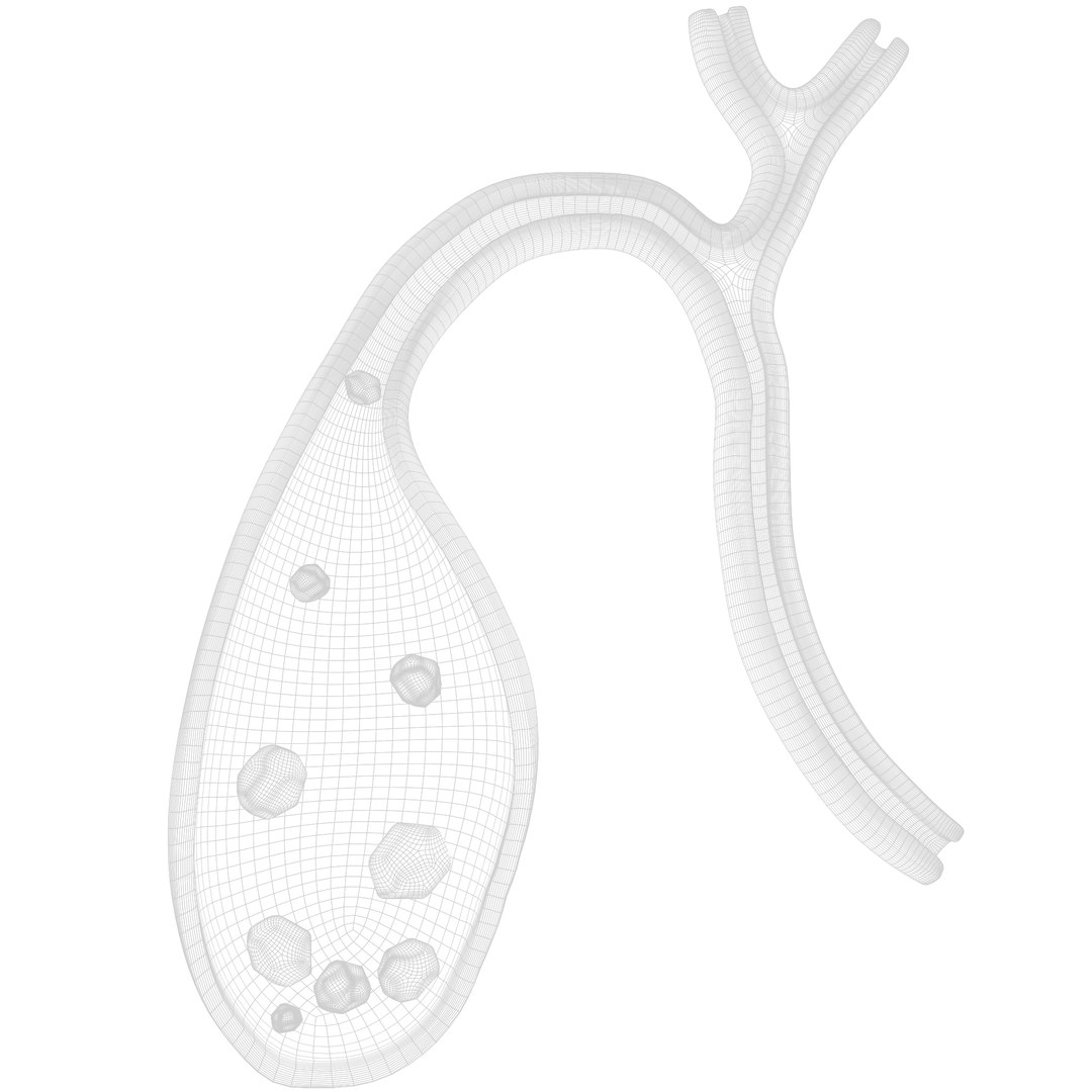 Gallbladder With Gallstones Model - TurboSquid 1842451