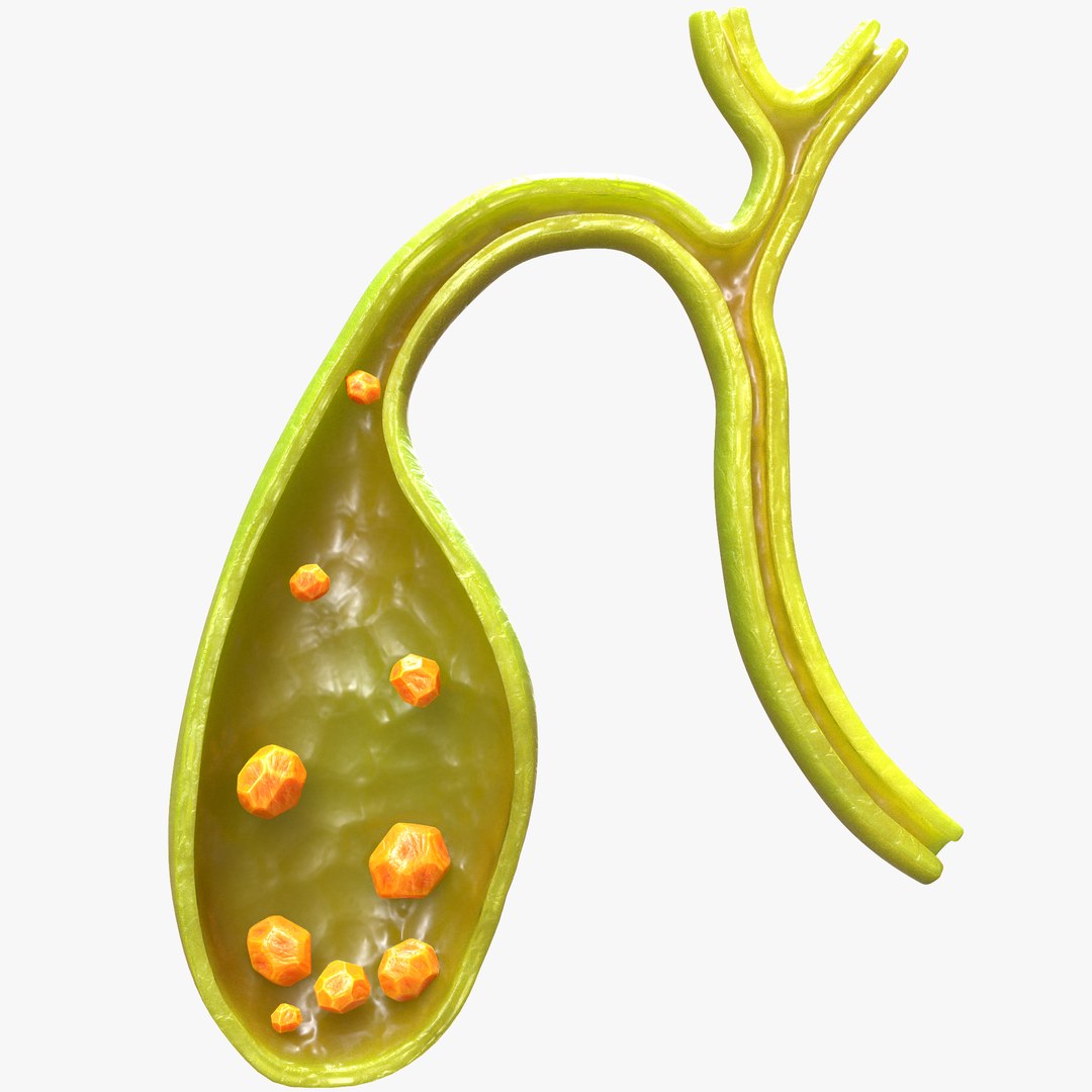 Gallbladder With Gallstones Model - TurboSquid 1842451