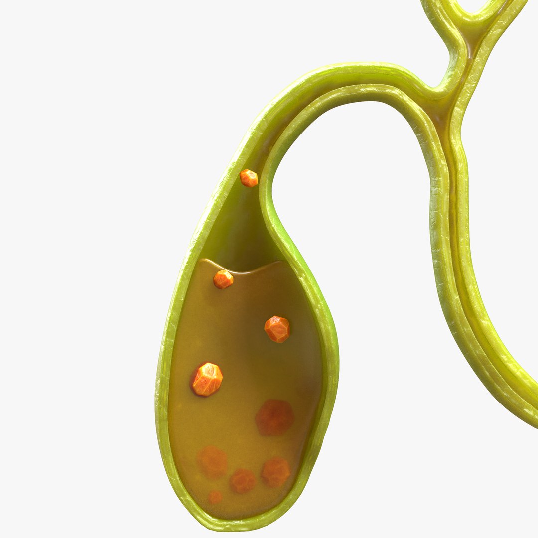 Gallbladder With Gallstones Model - TurboSquid 1842451