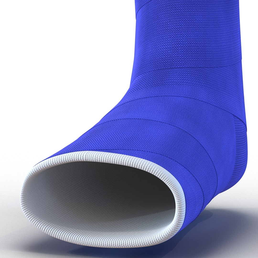 max blue fiberglass cast leg