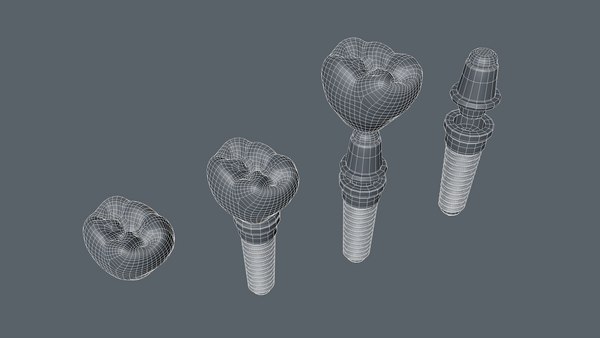 Dental implant 3D model - TurboSquid 1679544