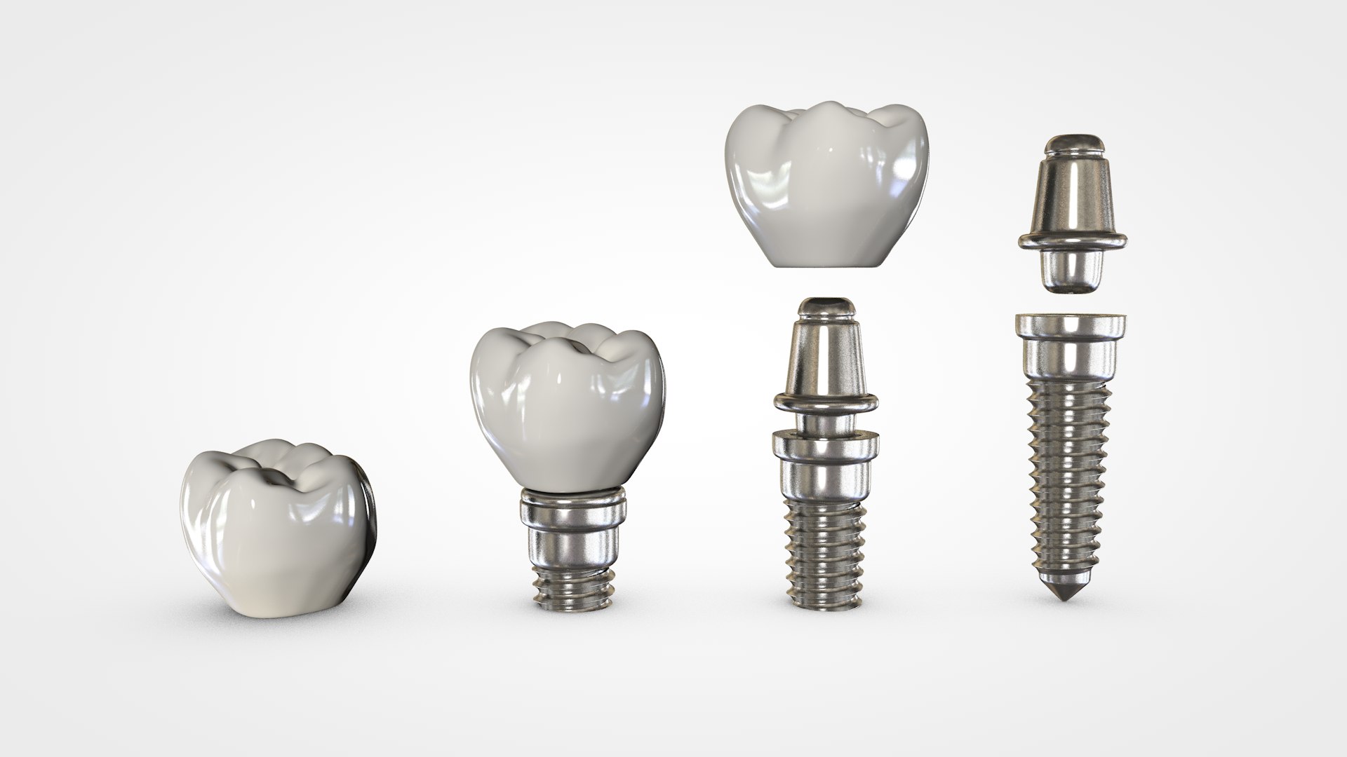 Dental Implant 3D Model - TurboSquid 1679544