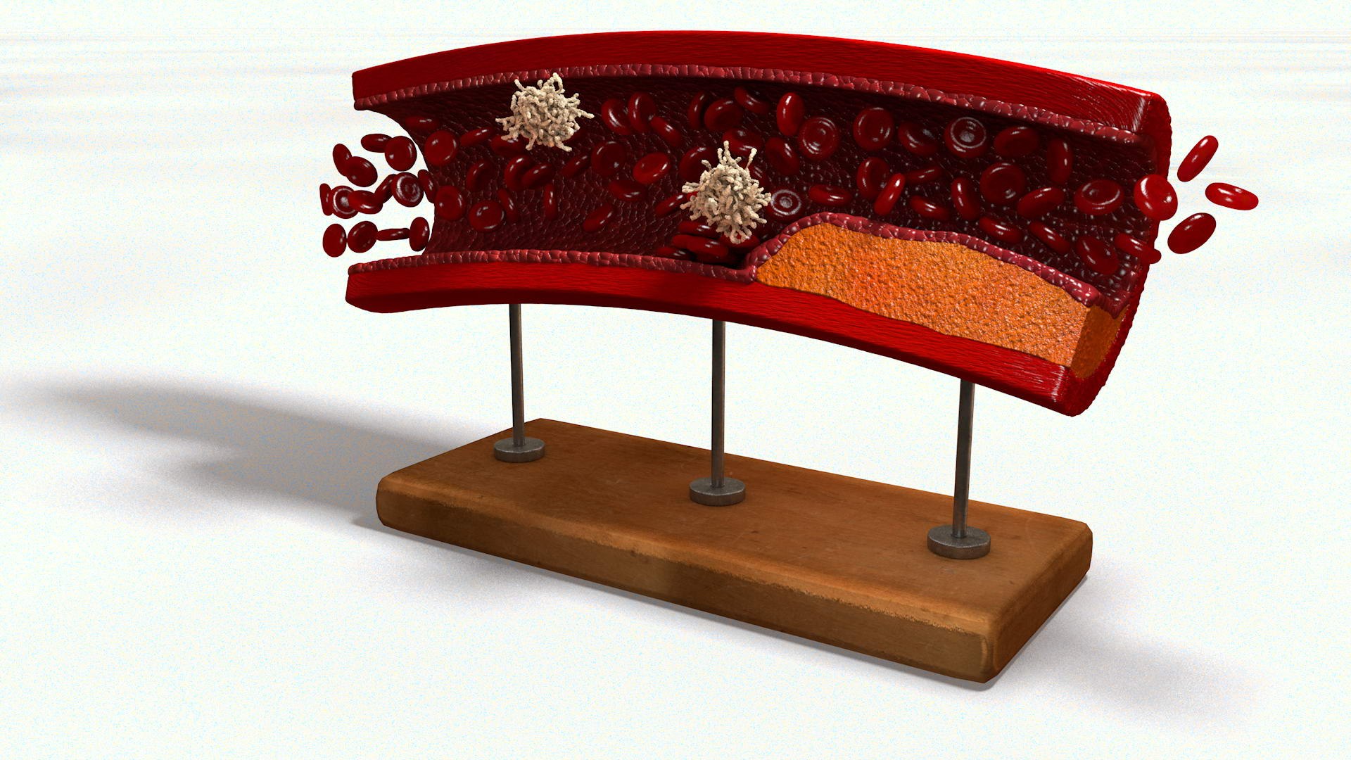 3D sclerotic plaque vessel model - TurboSquid 1210220