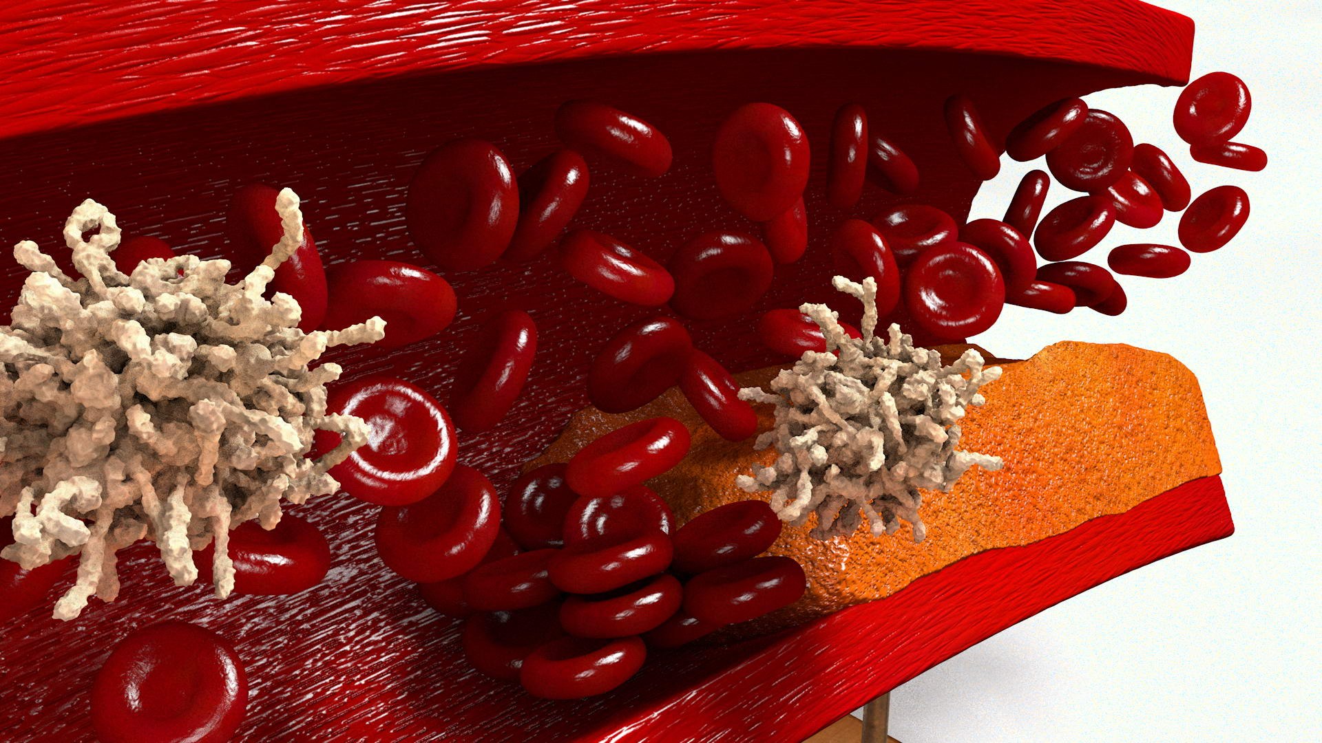 3D sclerotic plaque vessel model - TurboSquid 1210220