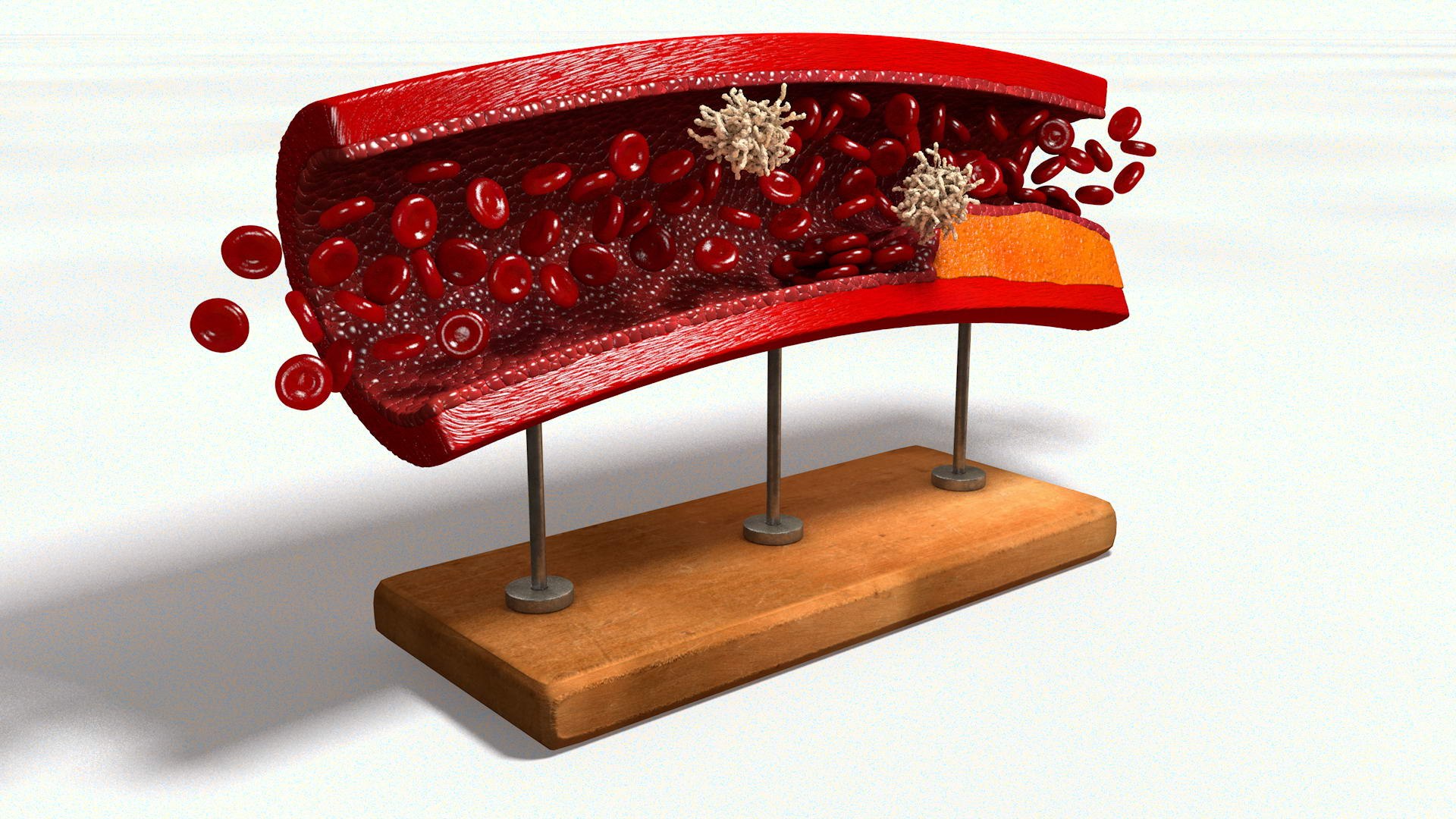 3D sclerotic plaque vessel model - TurboSquid 1210220