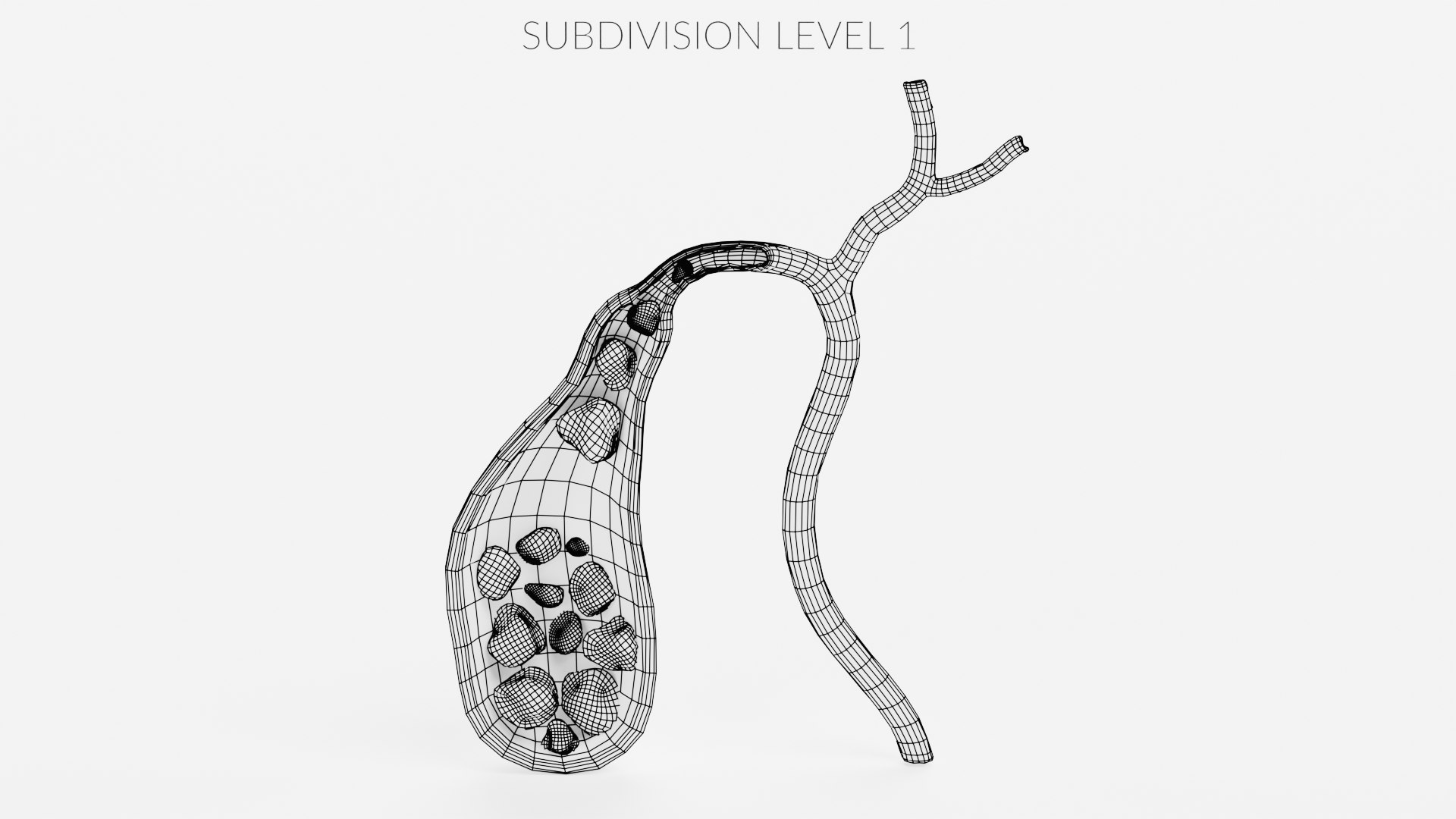 Gallbladder with Gallstones model - TurboSquid 1756732