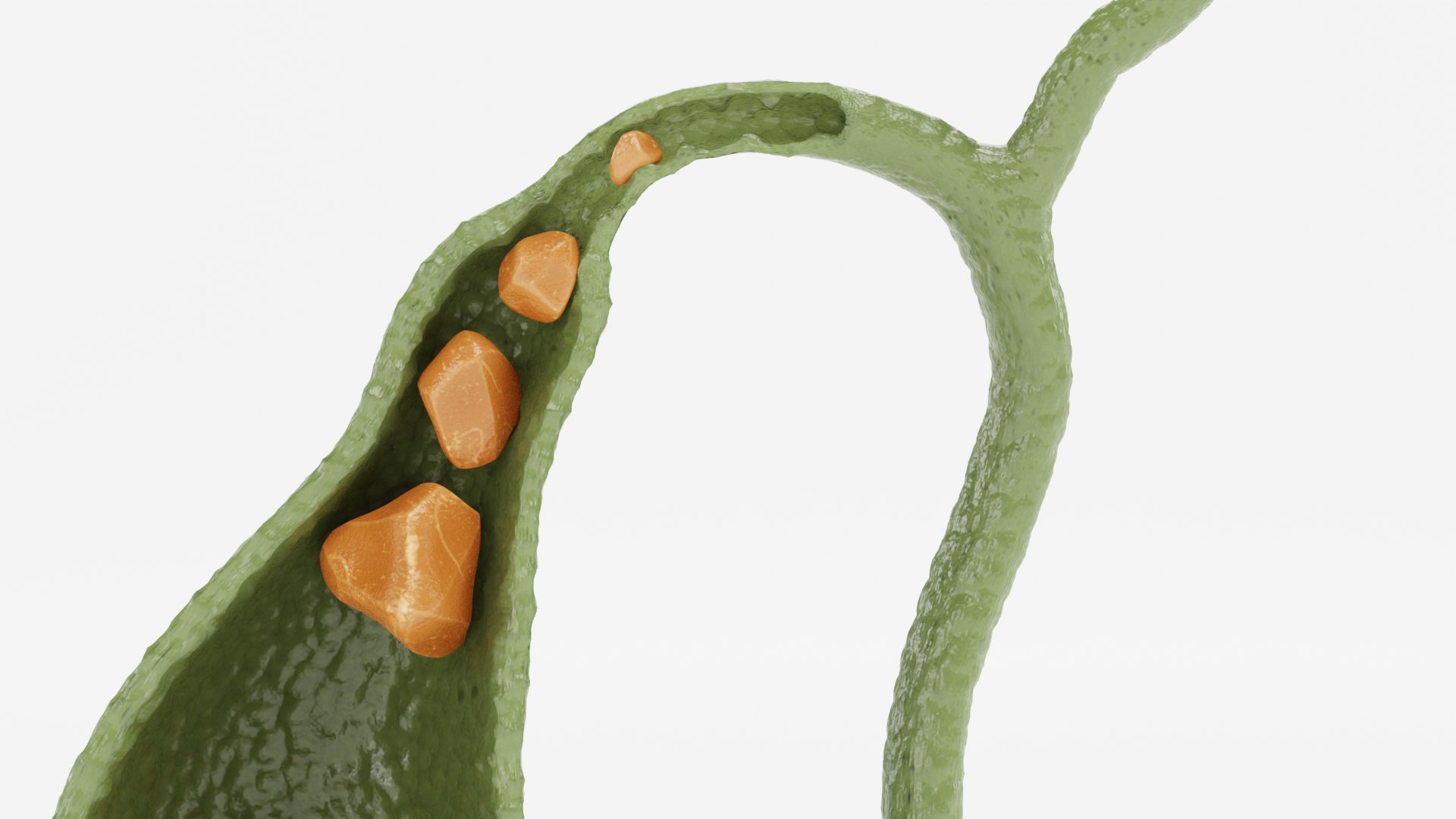 Gallbladder with Gallstones model - TurboSquid 1756732