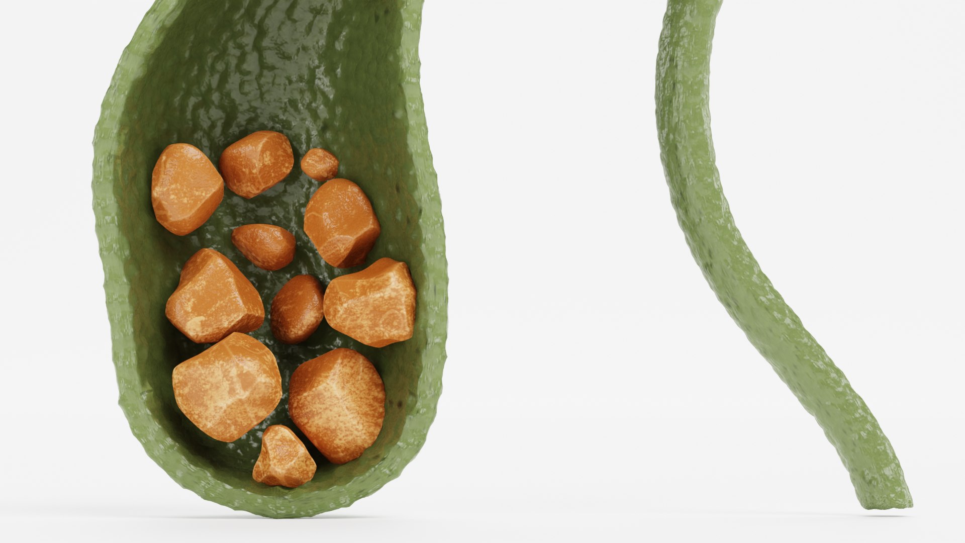 Gallbladder with Gallstones model - TurboSquid 1756732