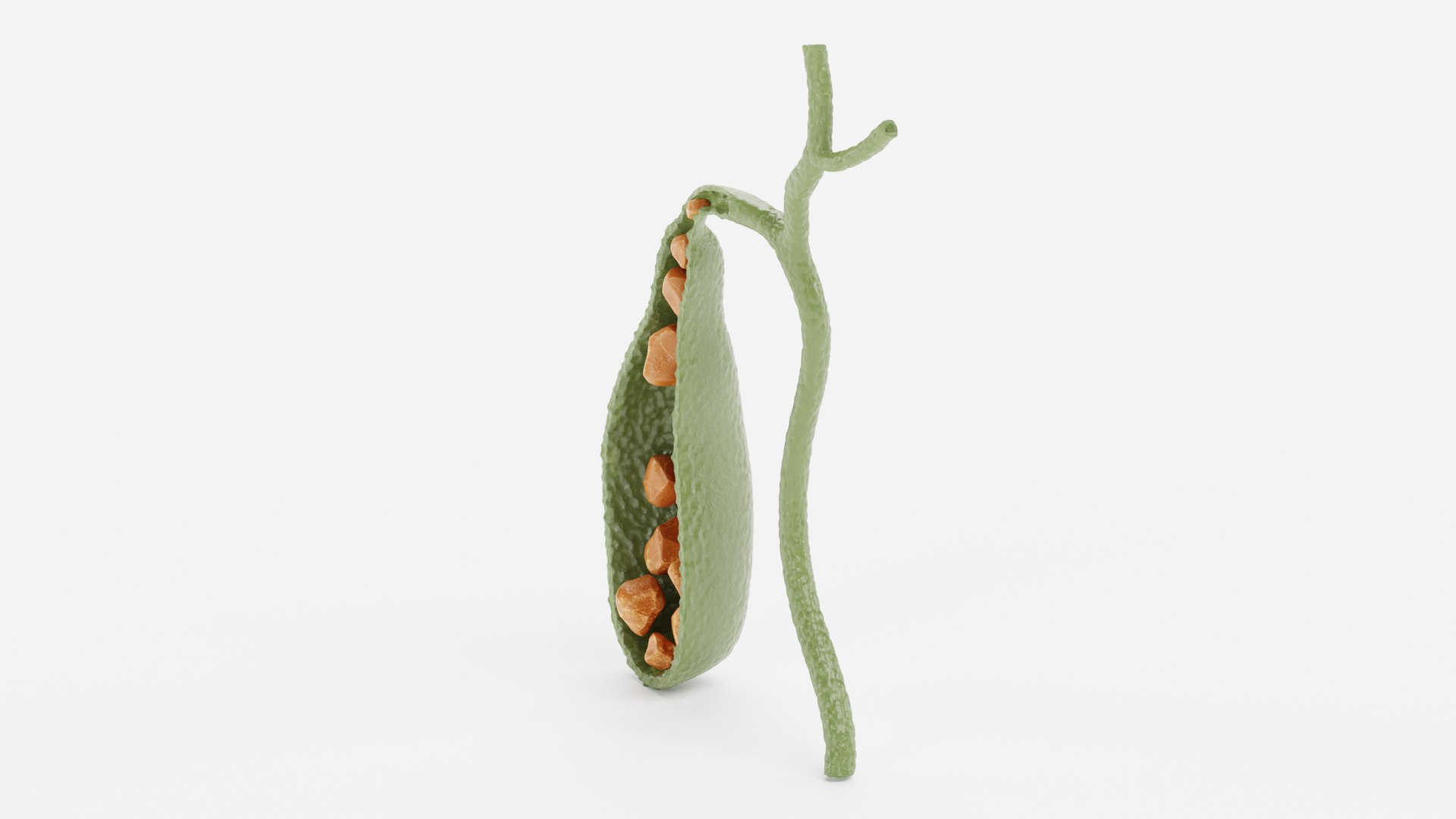 Gallbladder with Gallstones model - TurboSquid 1756732